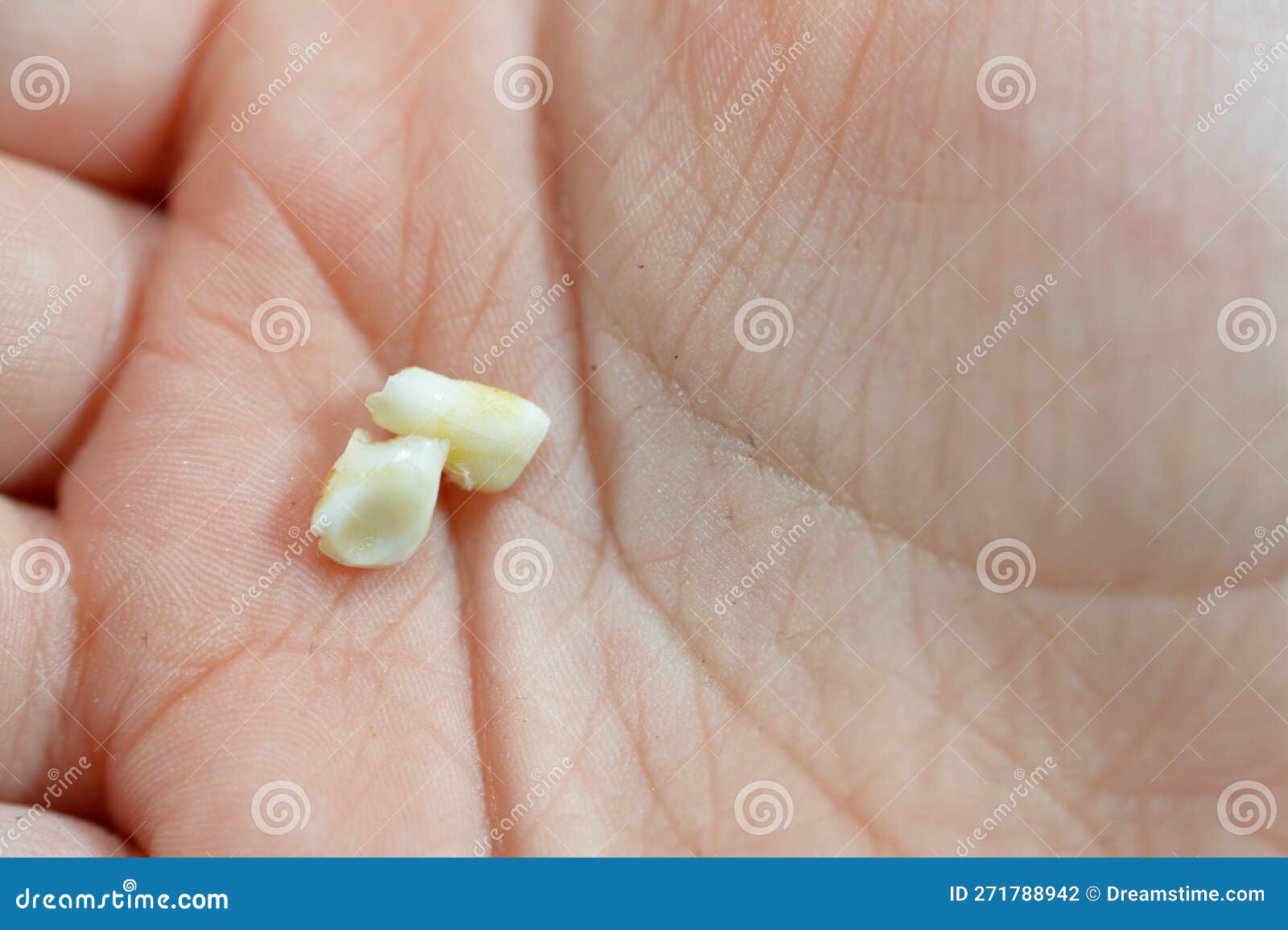 Deciduous Primary Baby Temporary Teeth, the First Set of Teeth in the ...