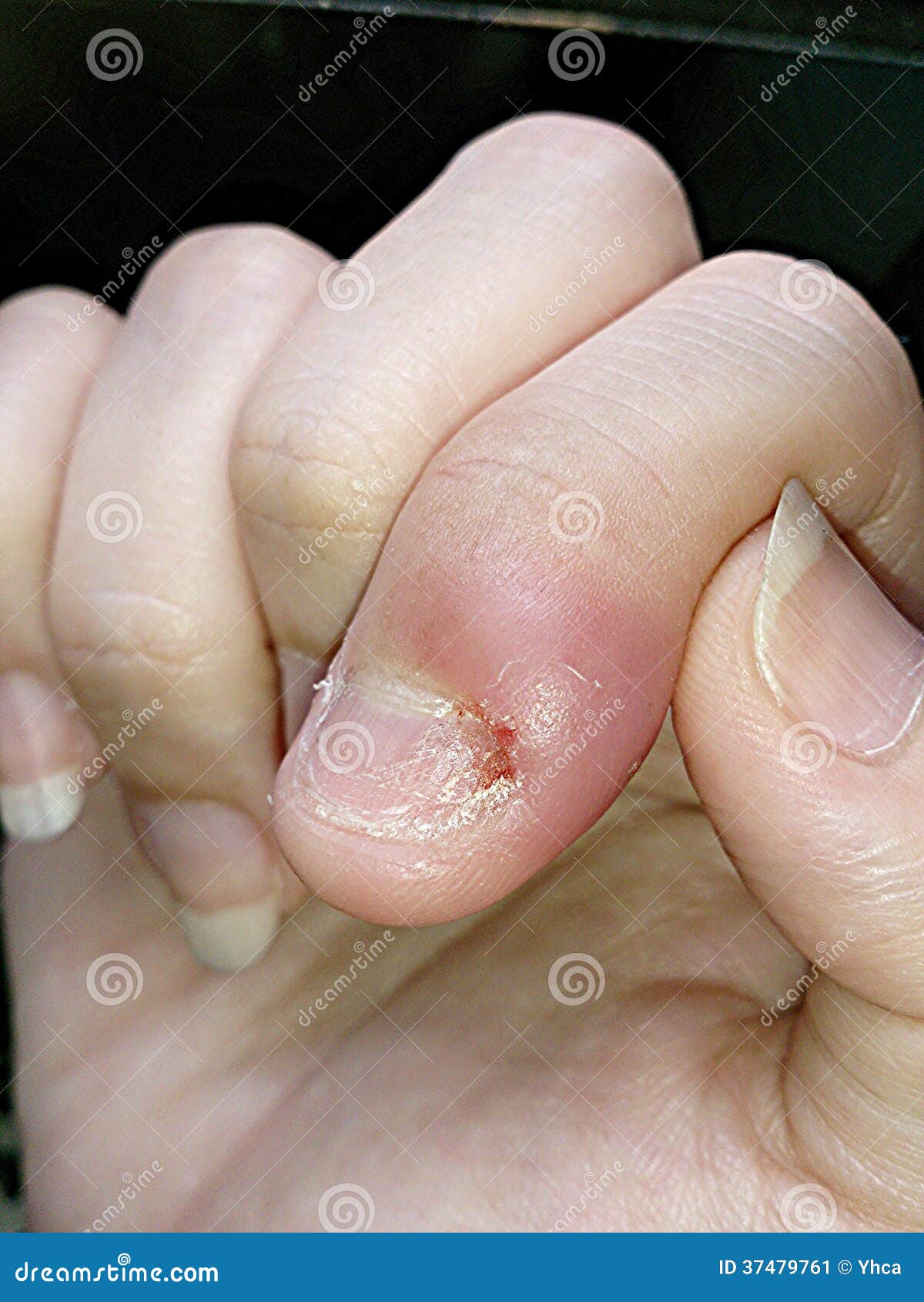 Dedo índice Derecho Hinchado Imagen de archivo - Imagen de dedo, piel ...