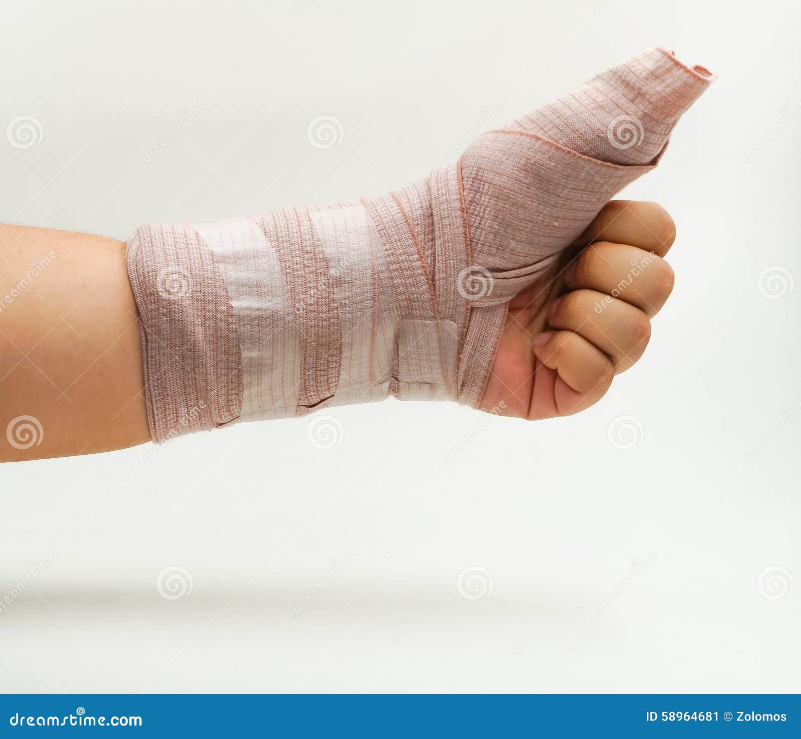 Dedo Da Tala Um Osso Quebrado Imagem de Stock - Imagem de medicina ...