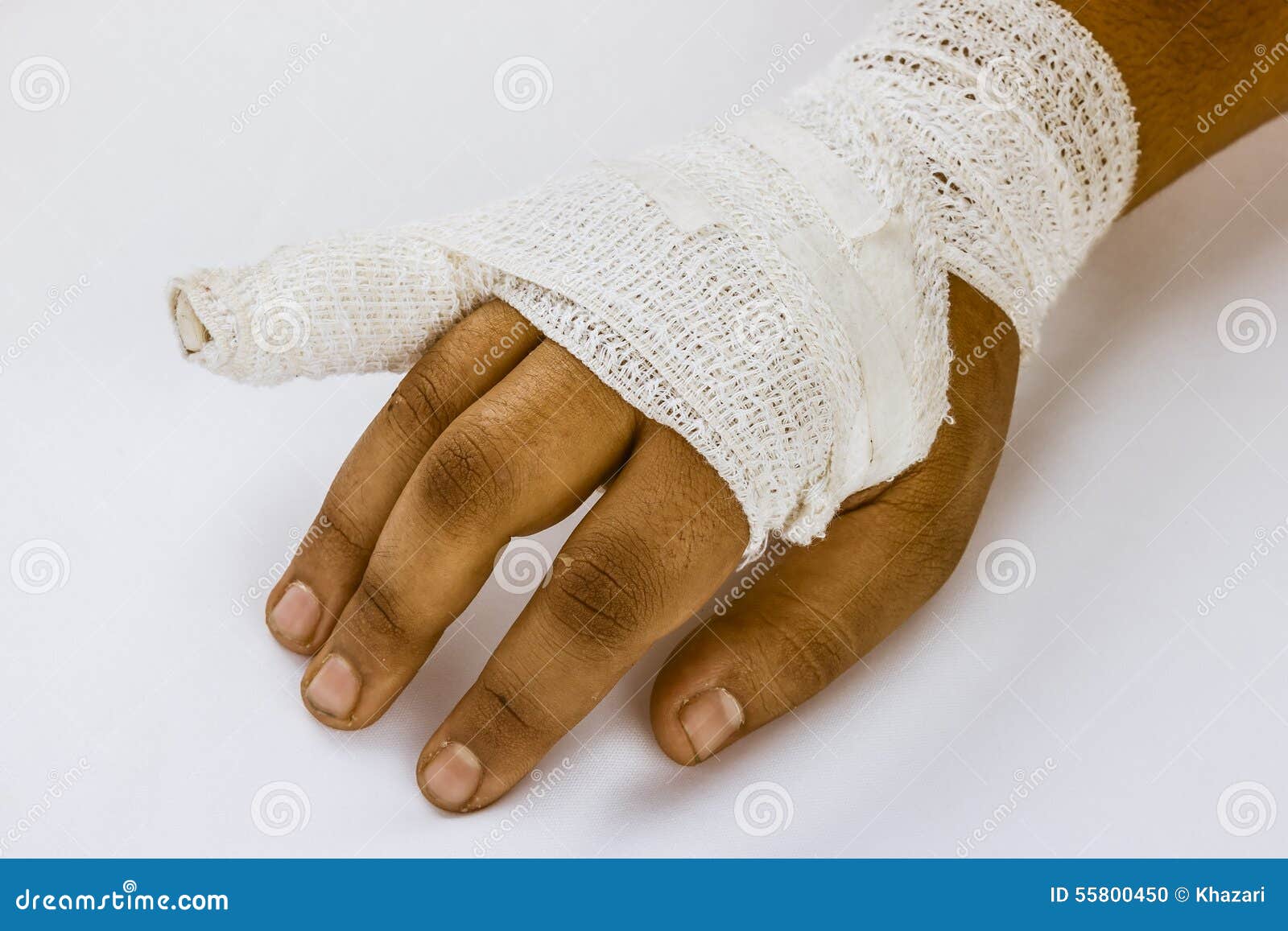 Dedo Da Tala Um Osso Quebrado Com Uma Atadura Foto de Stock - Imagem de ...