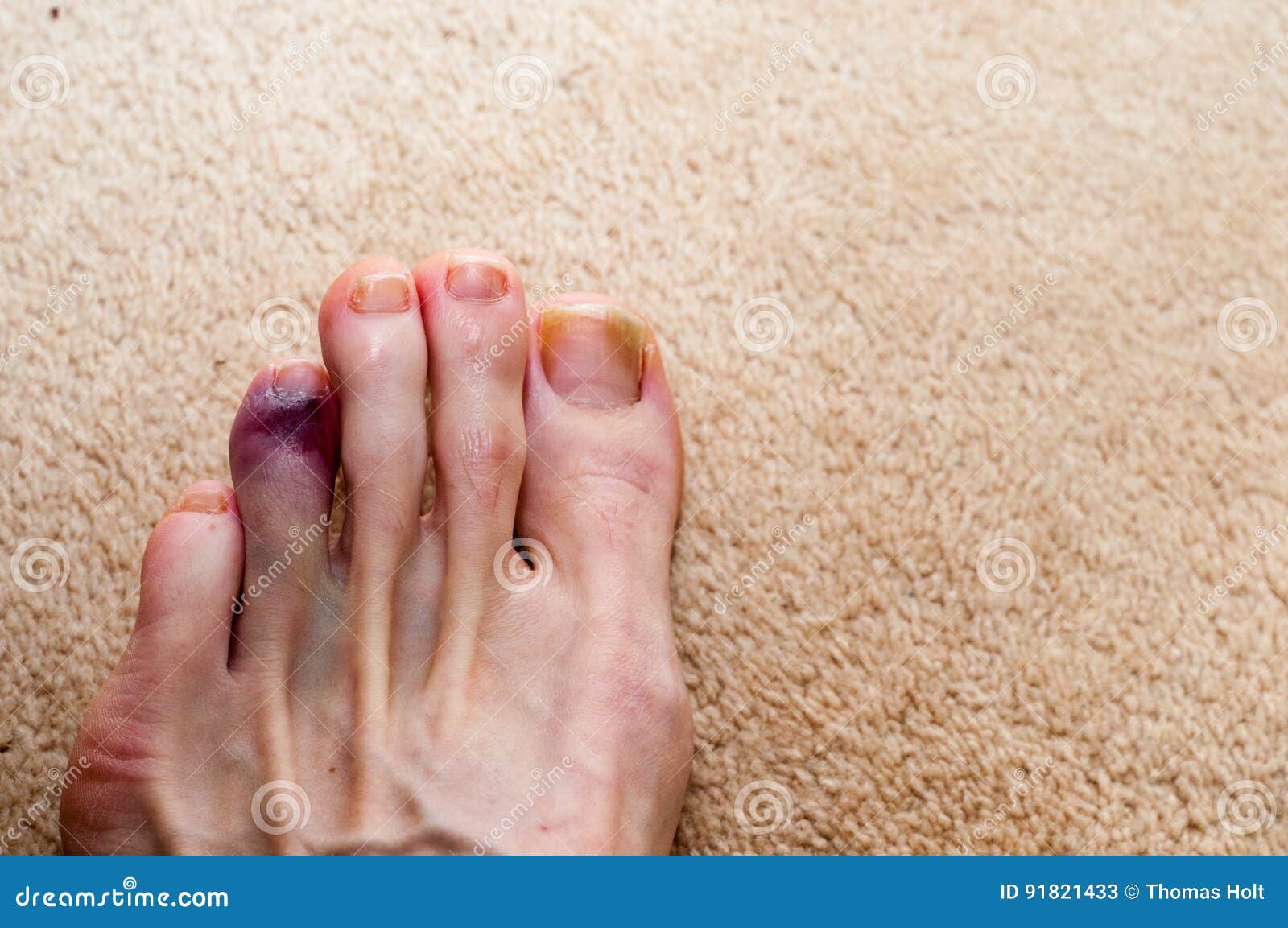 Dedo Do Pé Quebrado Que Mostra O Ferimento Na Pele Devido a Ferimento ...