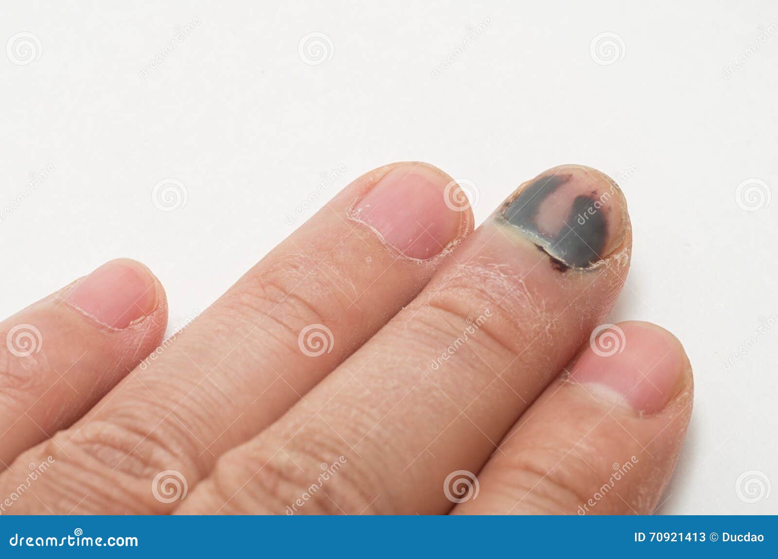 Dedo Medio Con El Clavo Contusionado Imagen de archivo - Imagen de piel ...