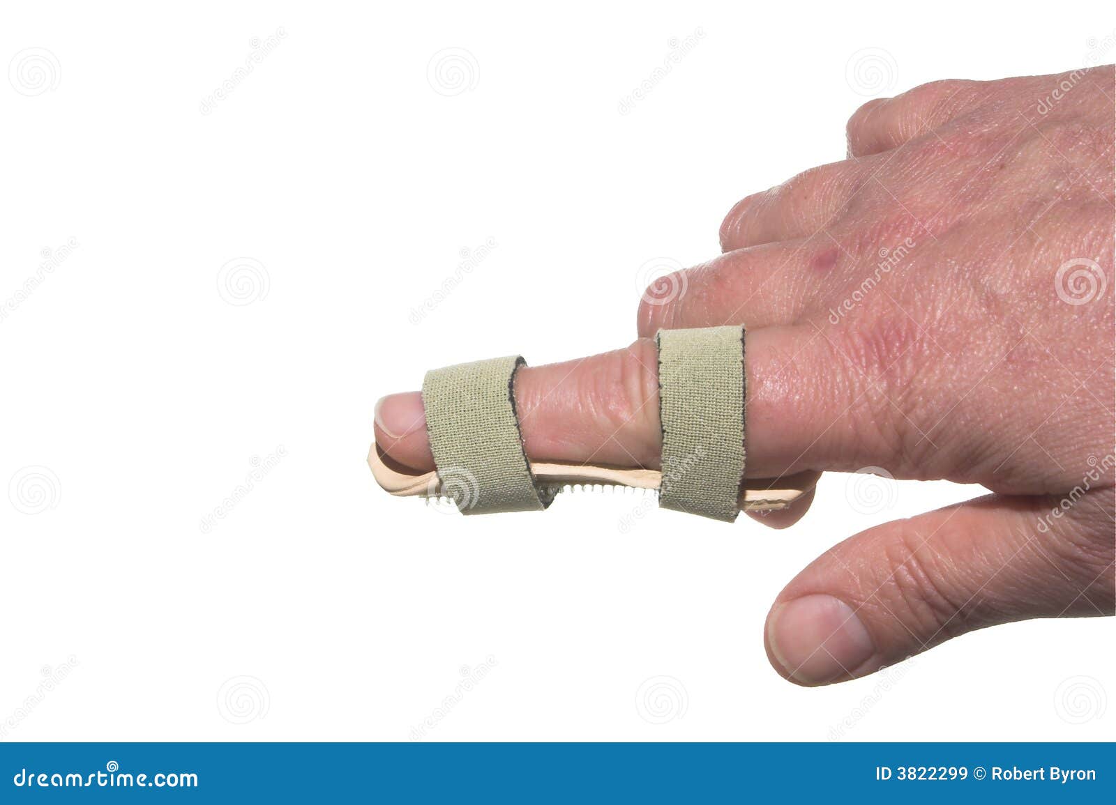 Dedo quebrado imagem de stock. Imagem de osso, sério, molde - 3822299