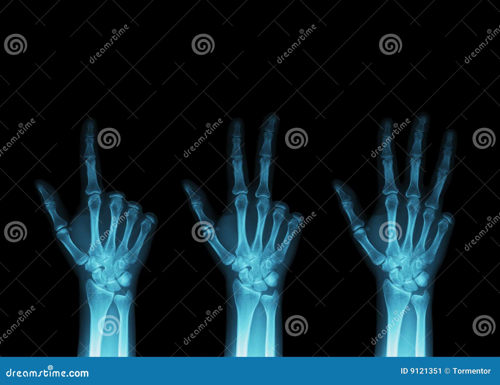 Dedos de la radiografía imagen de archivo. Imagen de derecho - 9121351