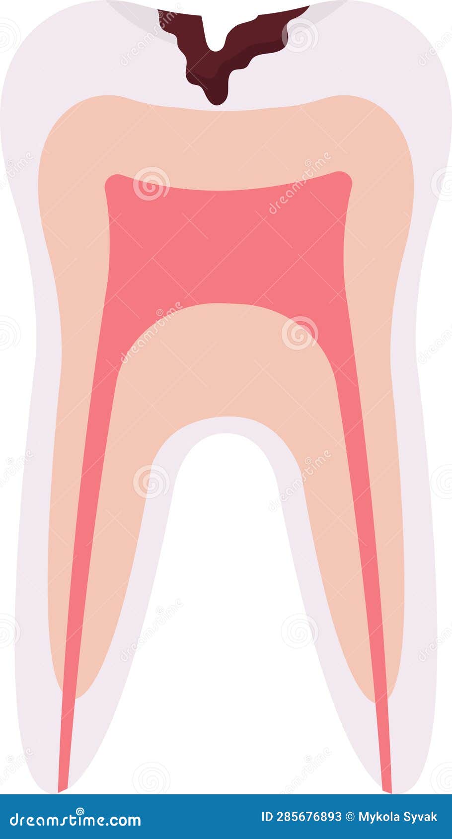 Deep Caries Tooth Problem stock vector. Illustration of medicine ...