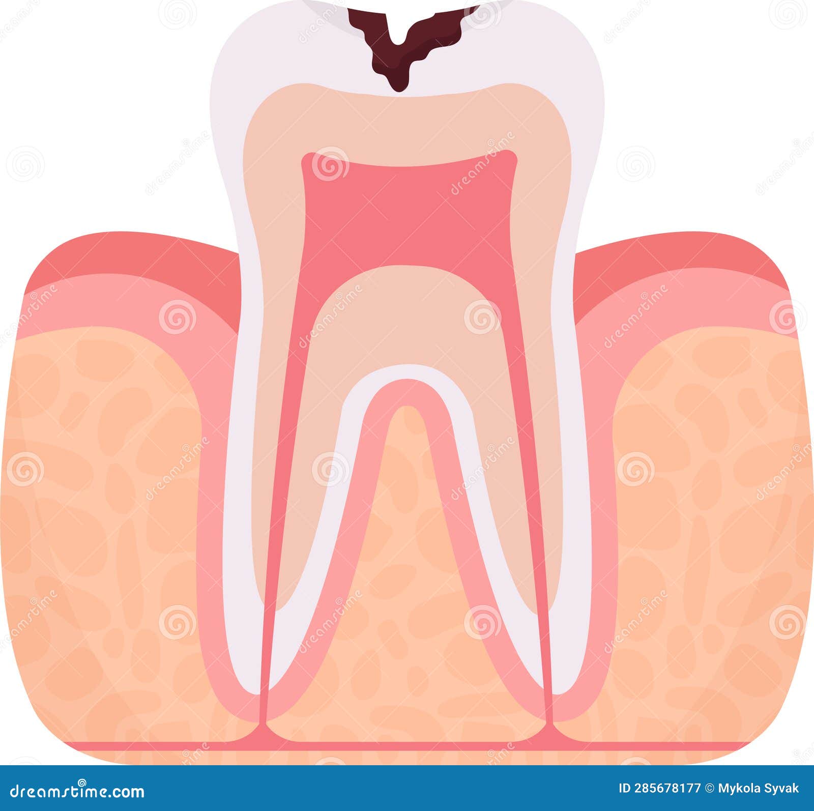 Deep Caries Tooth Problem stock vector. Illustration of dentistry ...