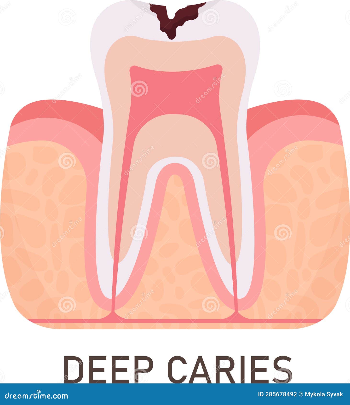 Deep Caries Tooth Problem stock vector. Illustration of care - 285678492