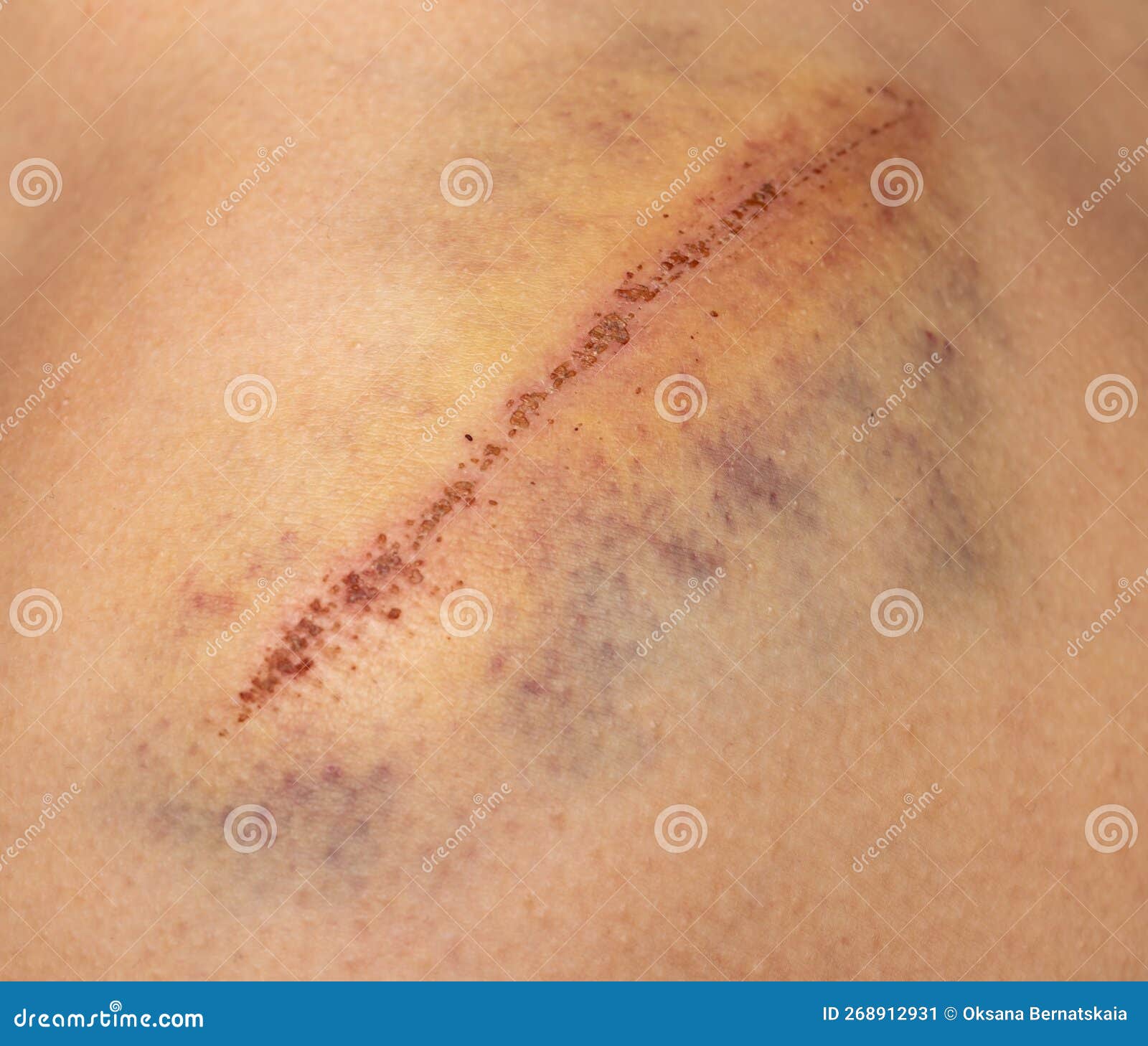 Deep Scratch with a Bruise on the Skin of the Shoulder Stock Image ...