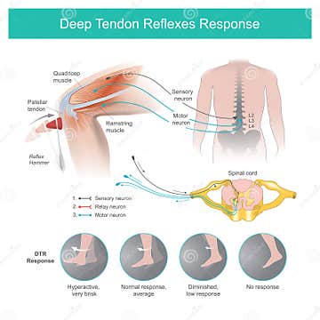 Deep Tendon Reflexes Response. Stock Vector - Illustration of tendon ...