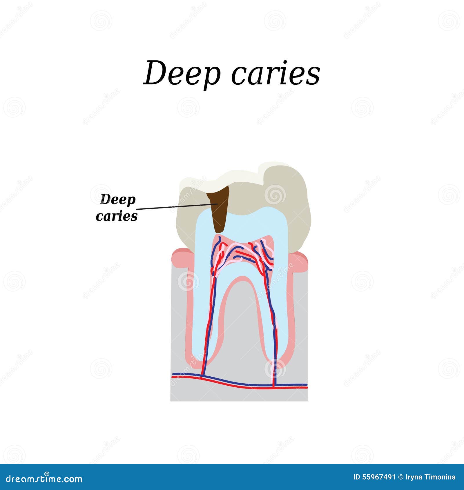 Deep Tooth Decay. Vector Illustration on Stock Vector - Illustration of ...