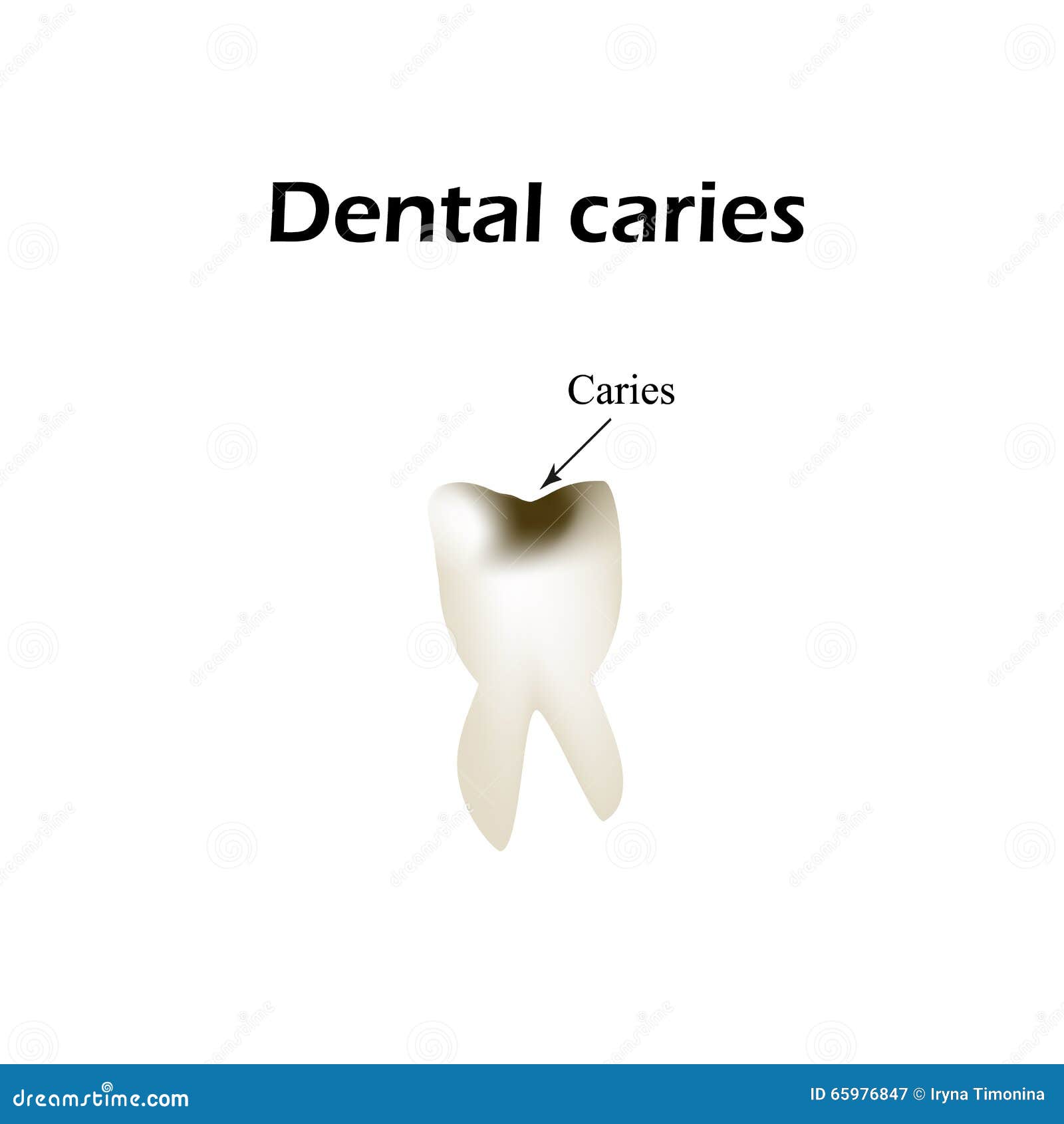 Deep Tooth Decay. Vector Illustration on Isolated Background Stock ...