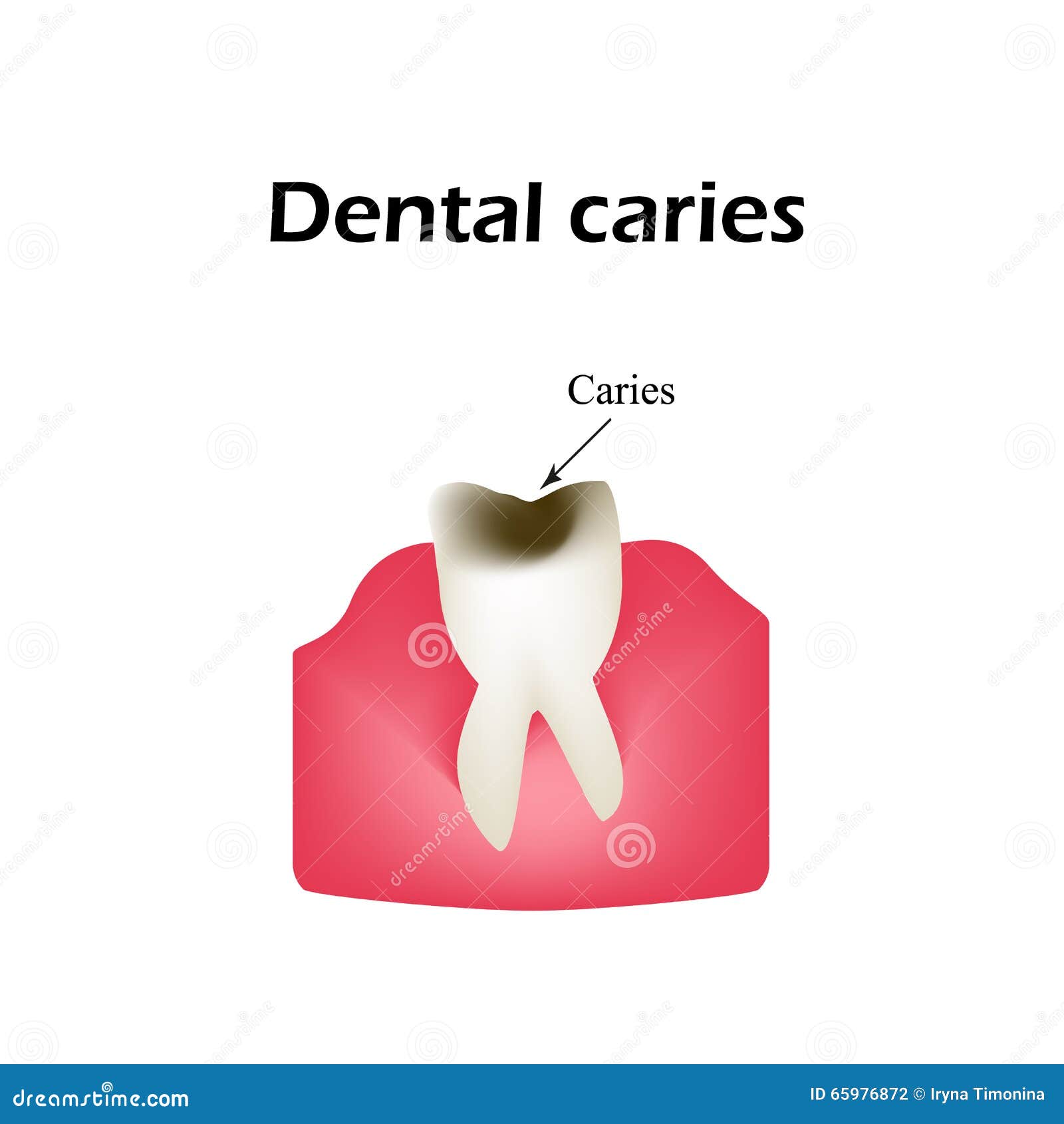 Deep Tooth Decay. Vector Illustration on Isolated Background Stock ...