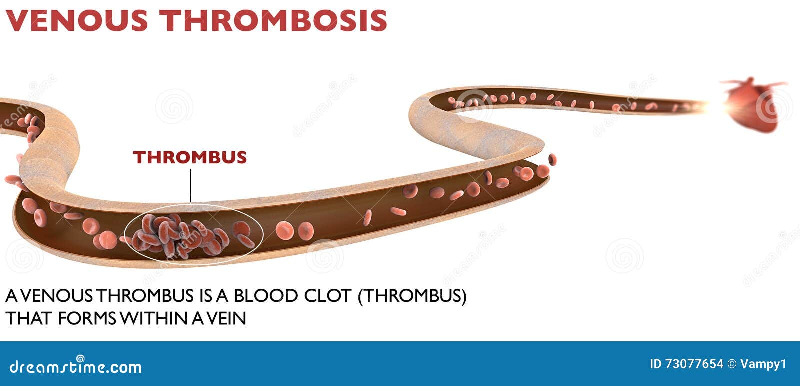 Deep Vein Thrombosis. Close-up Of Blood Vessel With Blood Clot Cartoon ...
