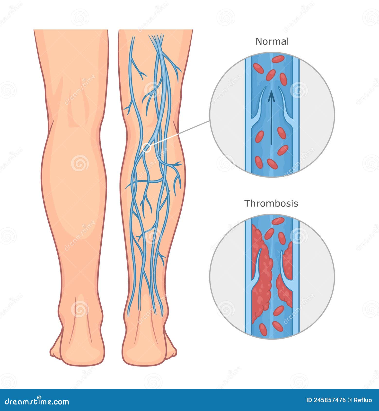 Deep Vein Thrombosis. Healthy Leg, And Leg With DVT. Sign And Symptoms ...