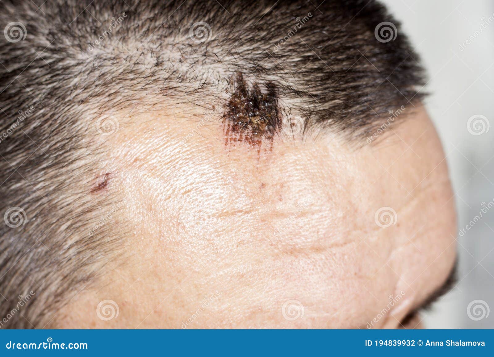 Deep Wound on the Forehead of a Middle-aged Man Stock Photo - Image of ...
