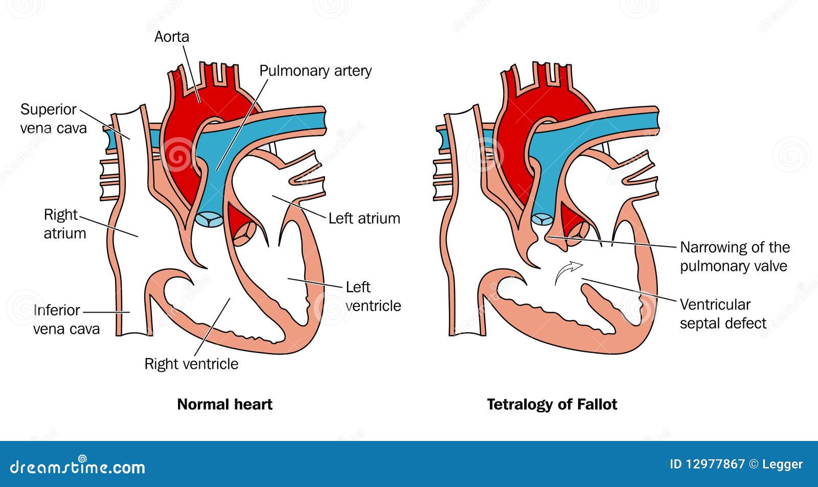 Defecto Congénito Del Corazón Ilustración del Vector - Ilustración de ...