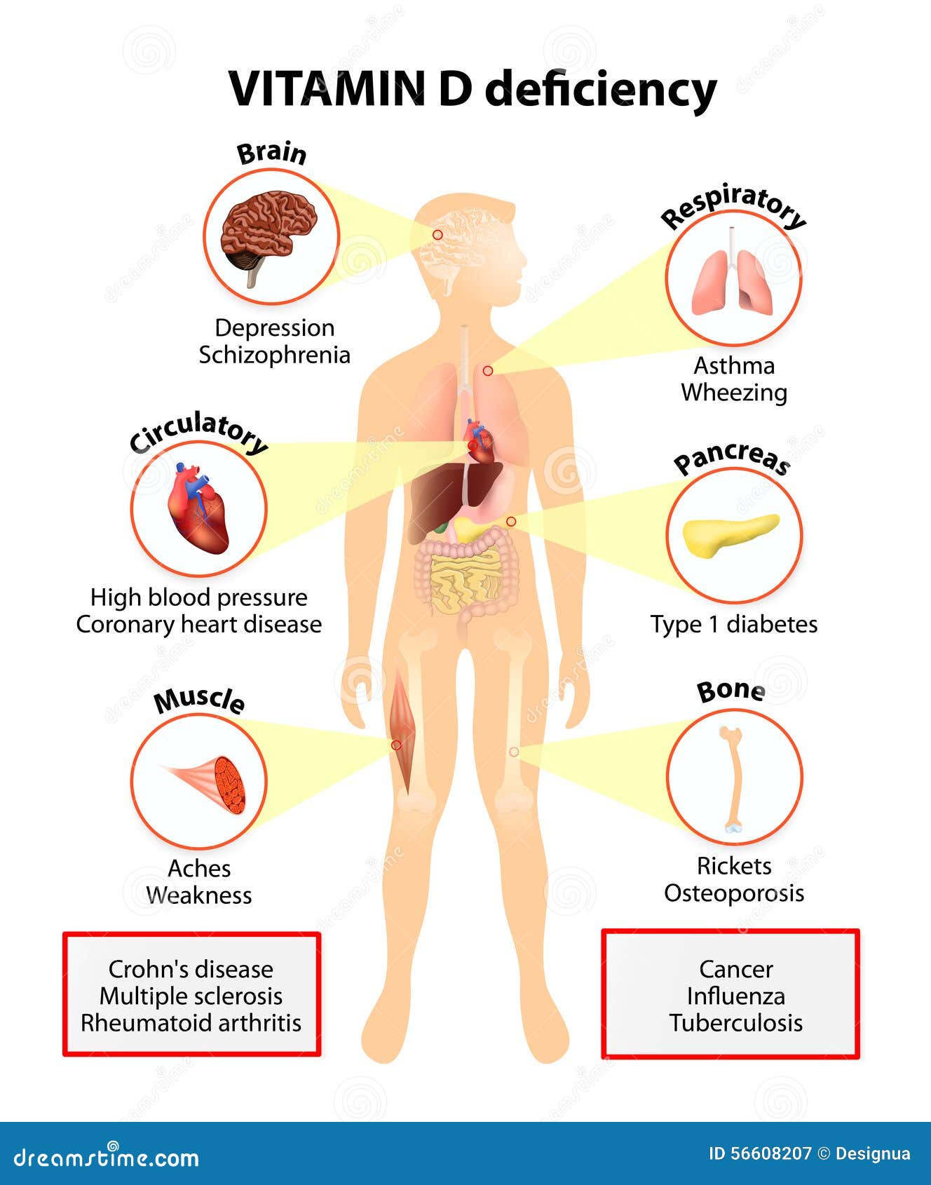 Deficiencia De La Vitamina D Síntomas Y Enfermedades Ilustración Del Vector Imagen 56608207
