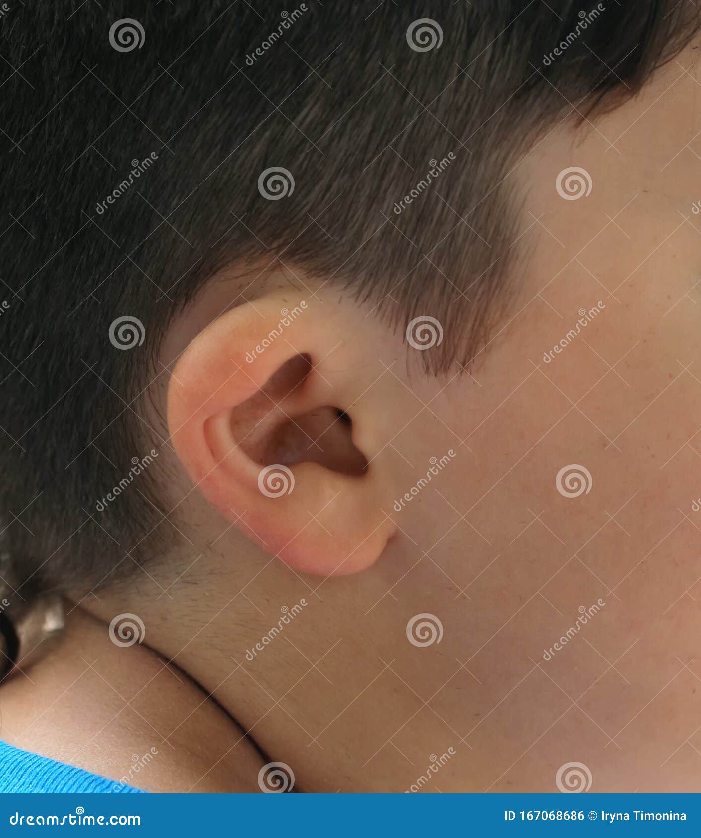 Deformation of the Ear. Irregular Shape of the Auricle. Stock Photo ...