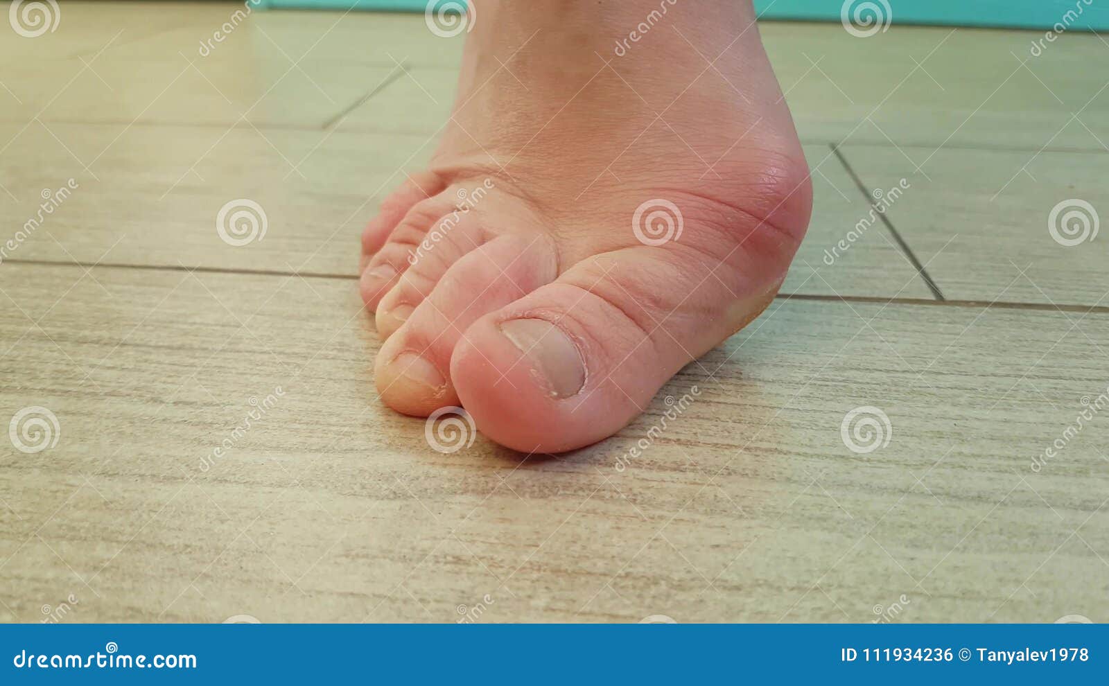 Deformation of the Joint on the Leg Stock Footage - Video of closeup ...