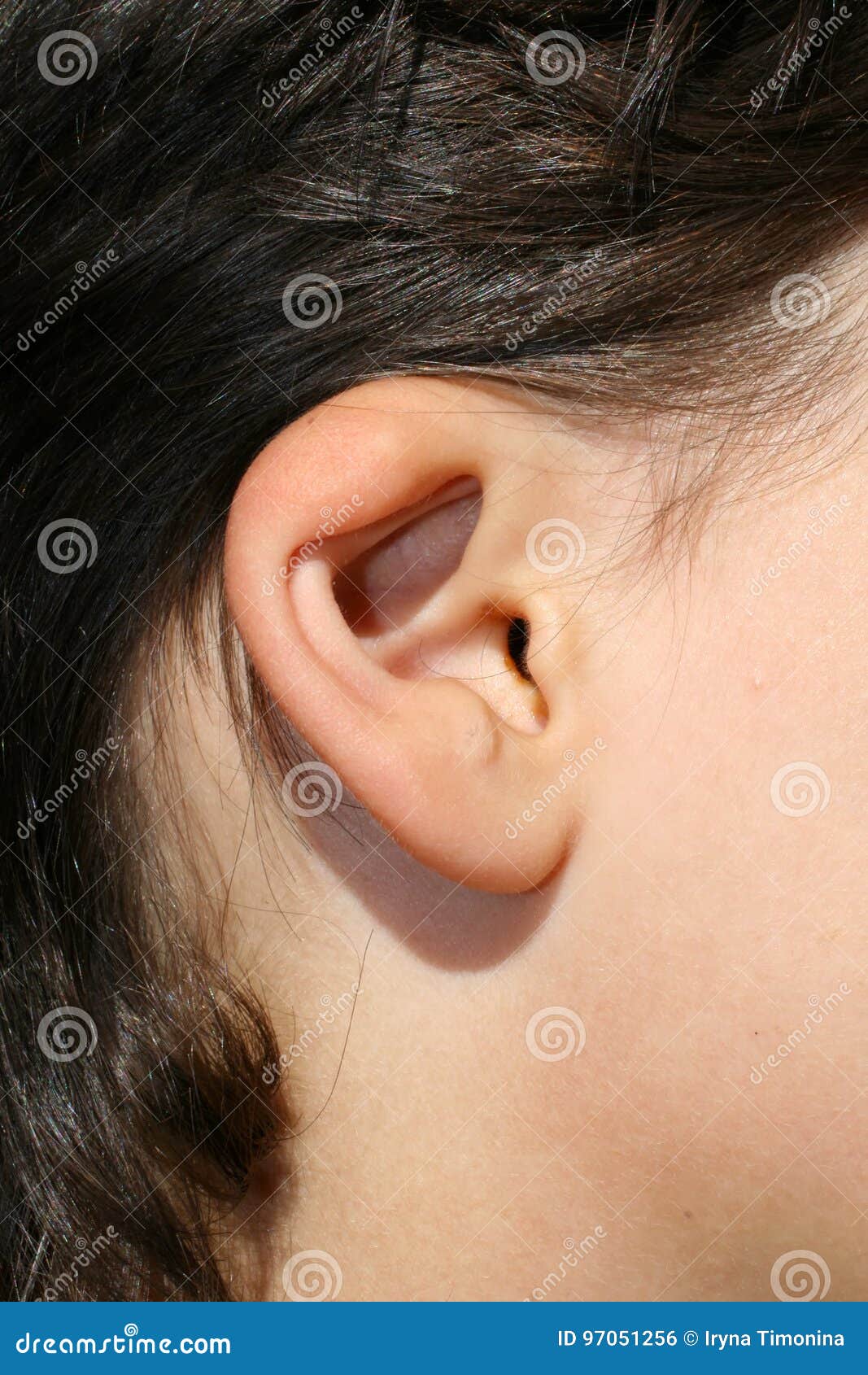 Deformed Ear. Abnormal Development of the Auricle Stock Photo - Image ...