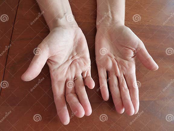 Deformed hands stock photo. Image of people, medical - 16211826