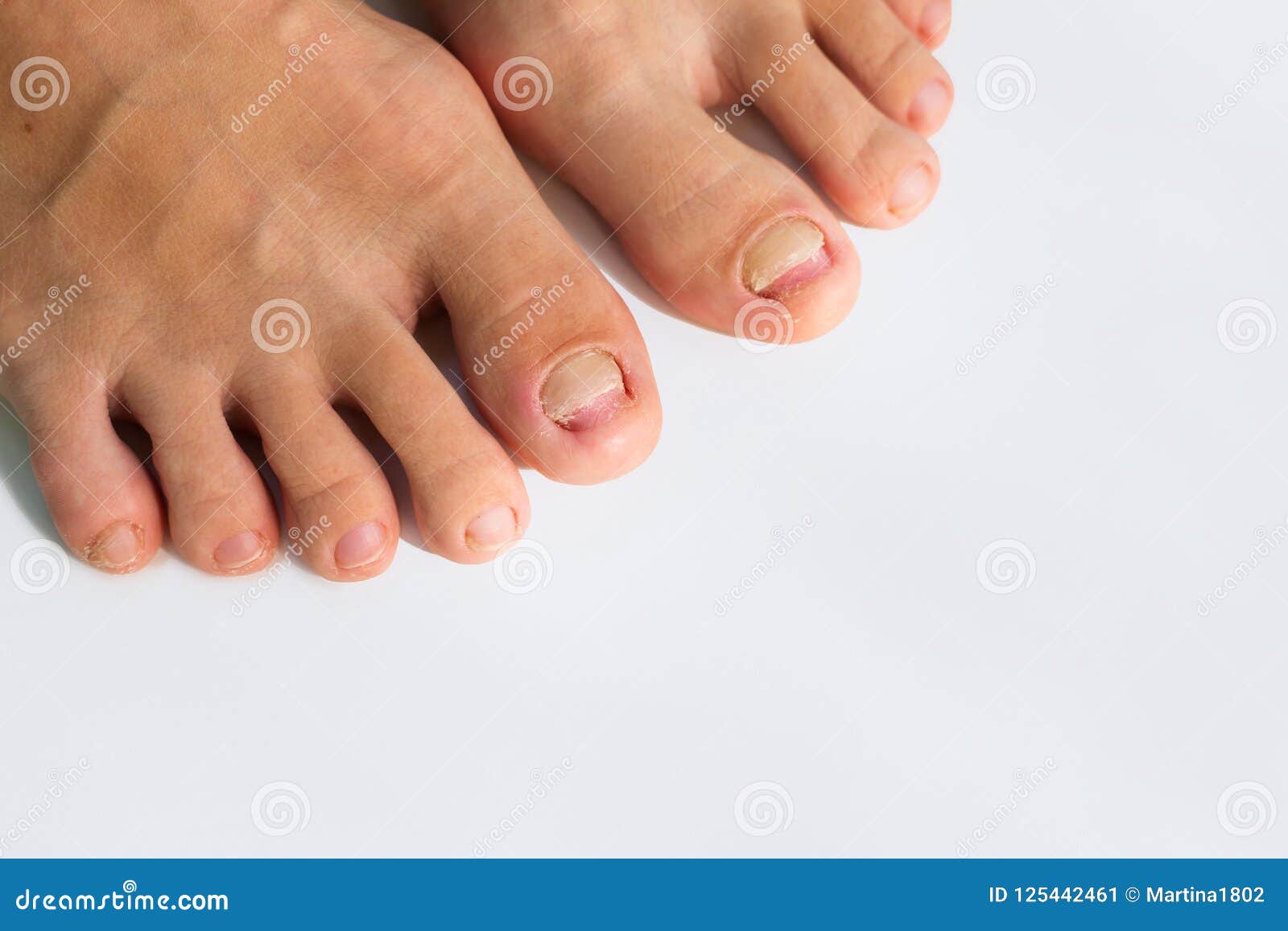 Deformed nails on the legs stock image. Image of agnail - 125442461