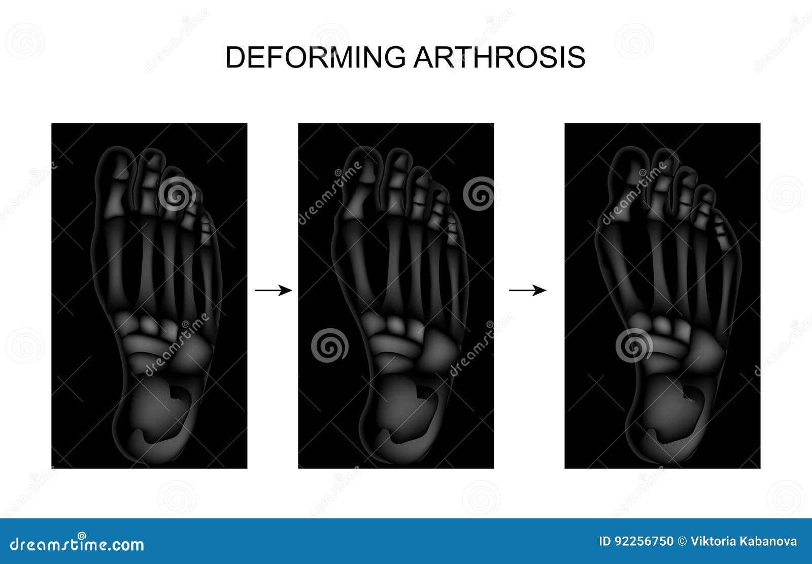 Deforming Arthrosis of the Foot Stock Vector - Illustration of body ...