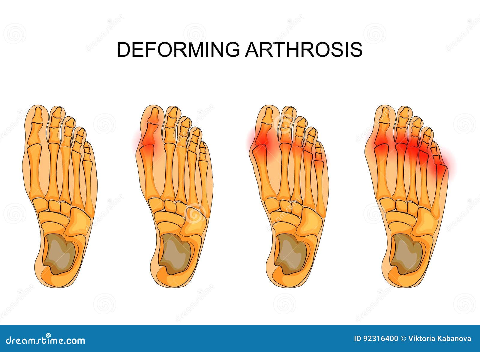 Arthrosis In The Foot Royalty-Free Illustration | CartoonDealer.com ...