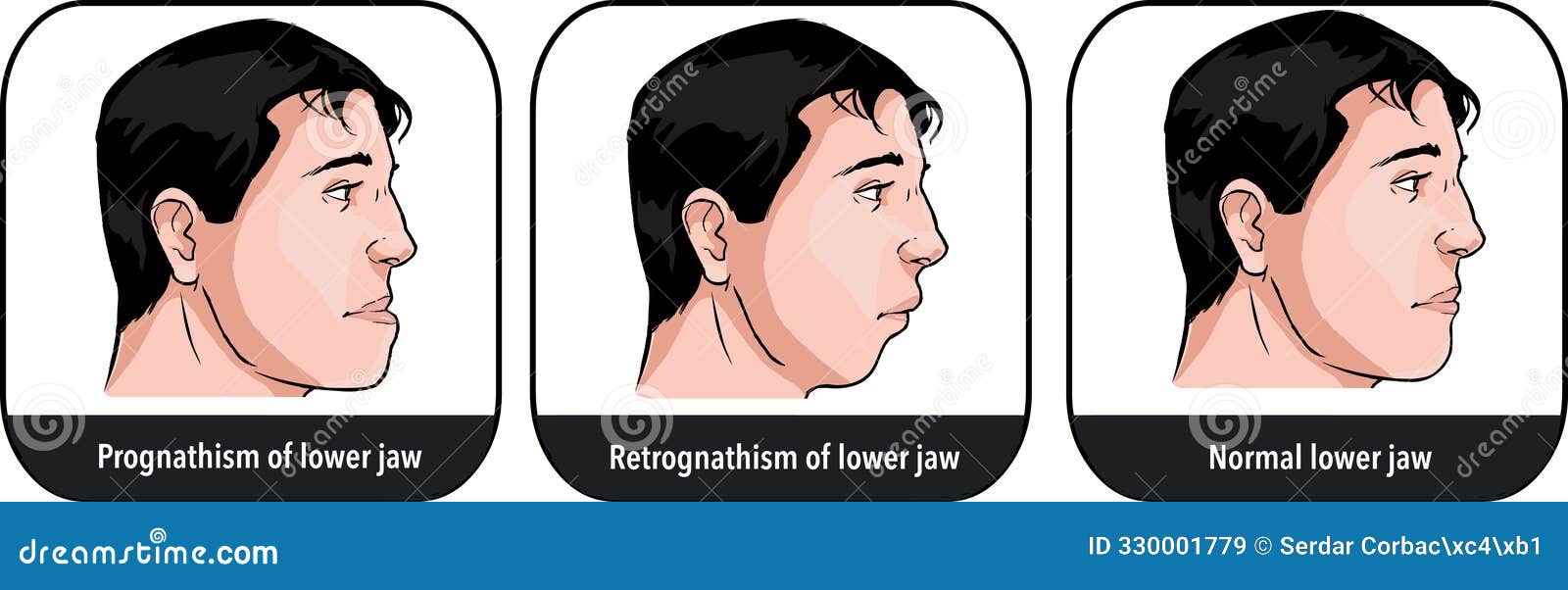 Distal, Normal, And Mesial Bite Profile, Vector Illustration. Overbite ...