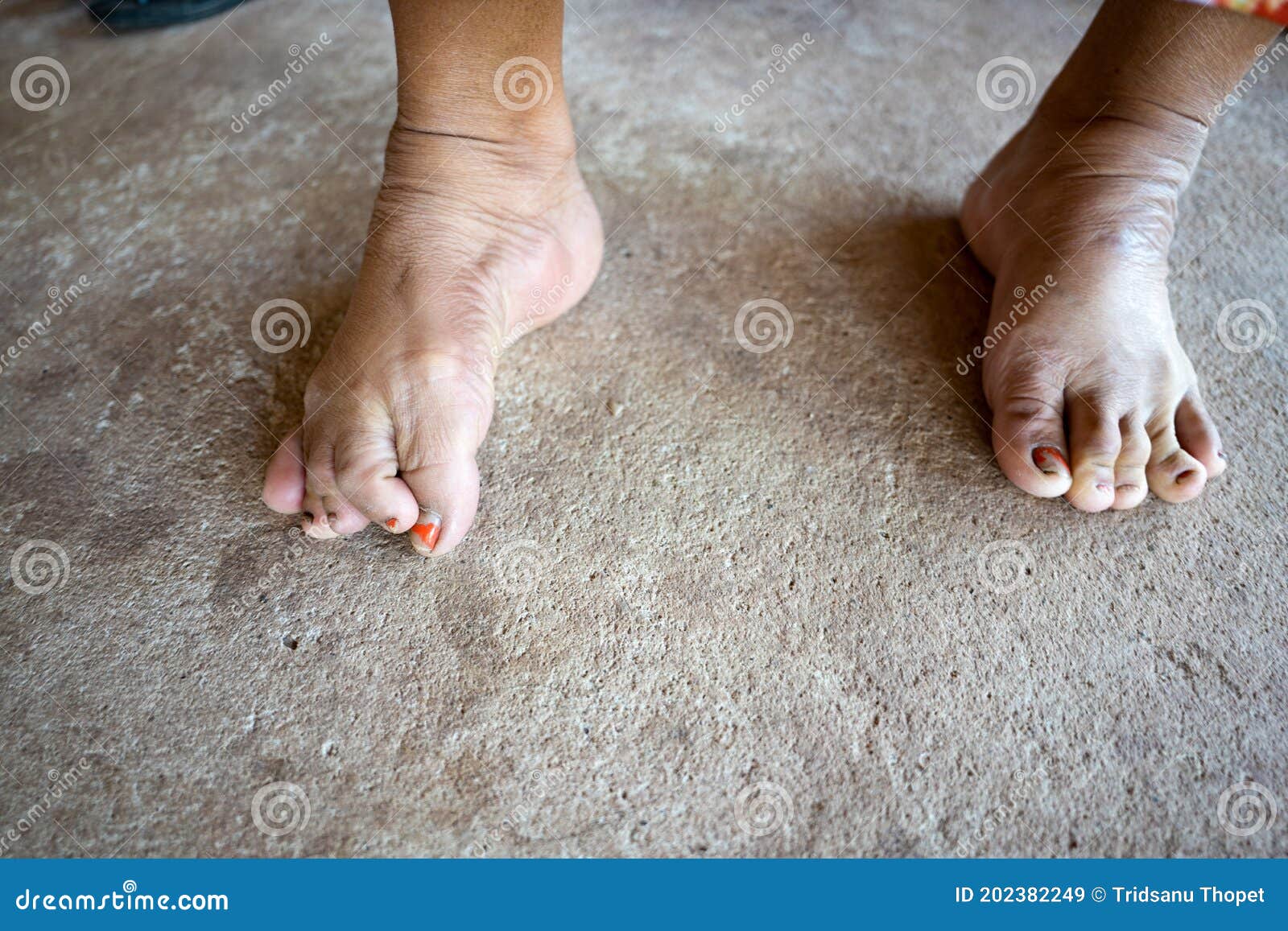 Deformity Right Foot by Poliomyelitis Stock Image - Image of health ...