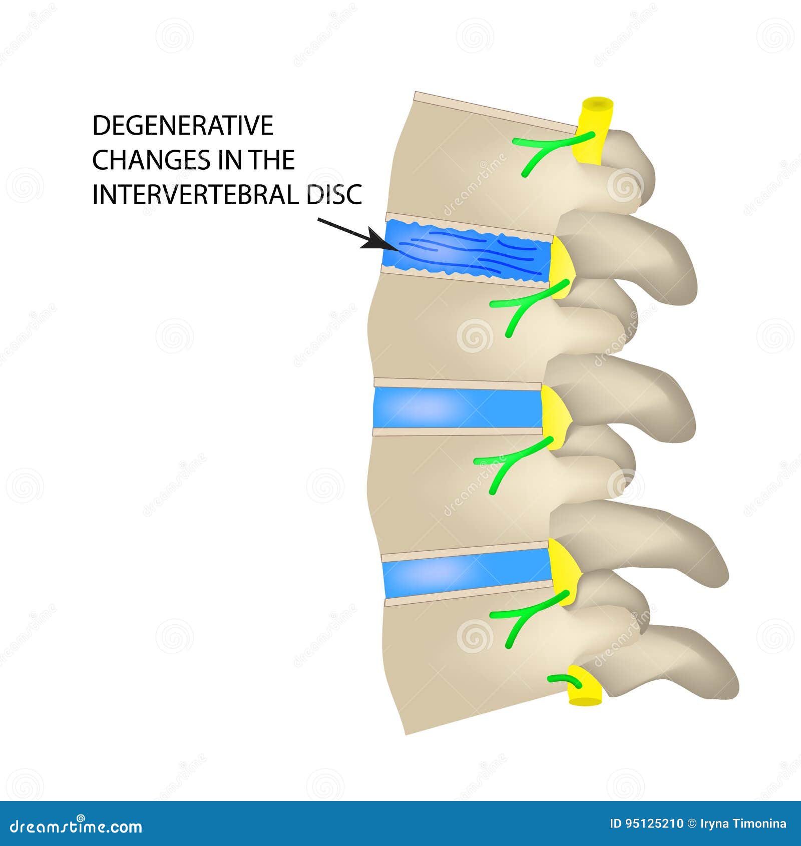 Degenerative Changes in the Intervertebral Disc. Vector Illustration on ...