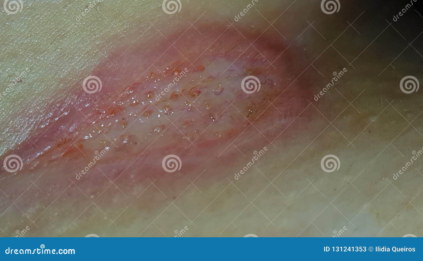 Skin burning stock image. Image of skin, degree, pain - 131241353