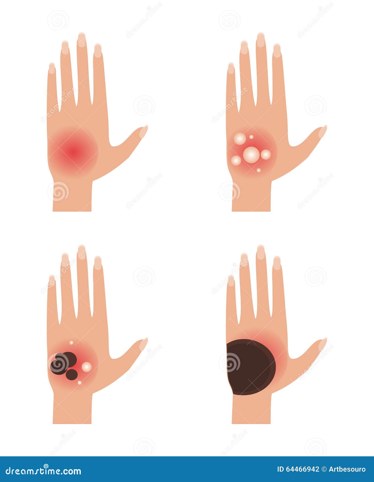 Electrical Burns Clipart How To Prevent Electric Shock | Denver