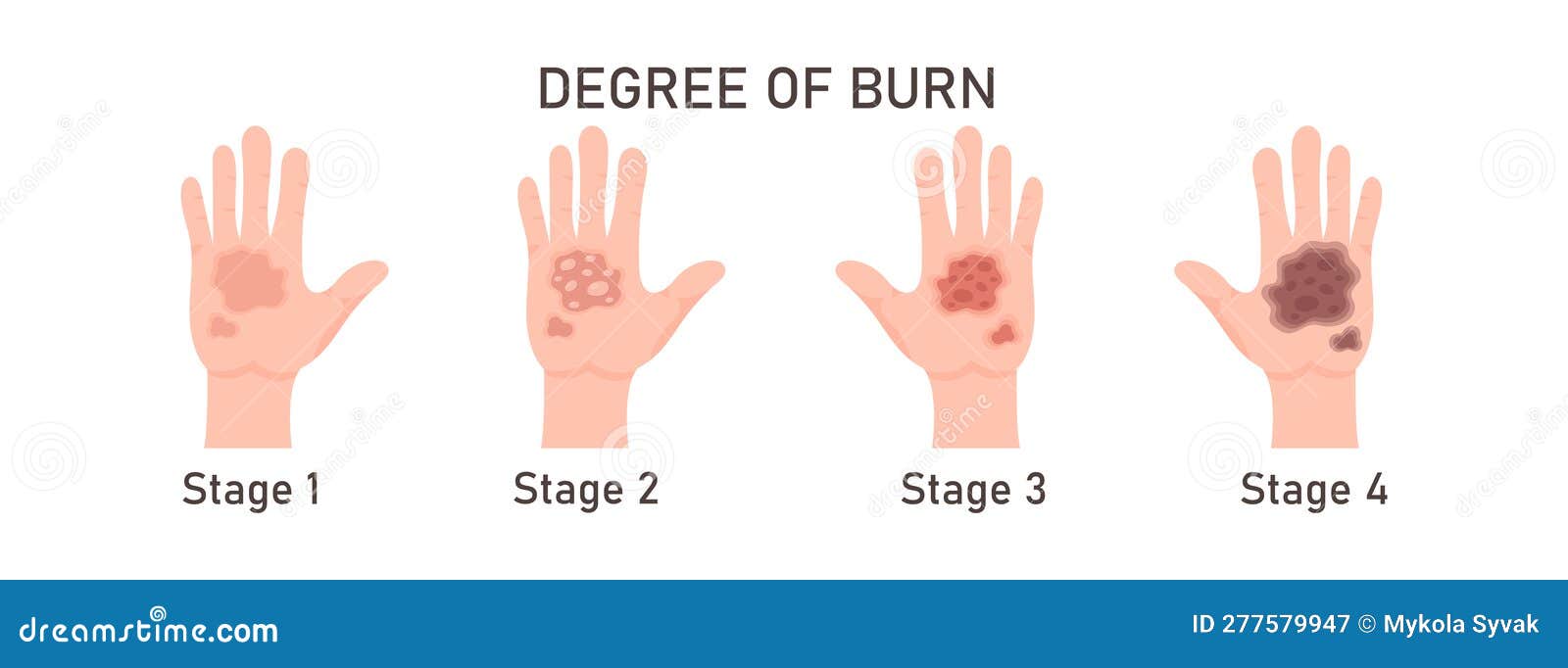 Degree of Skin Burn stock vector. Illustration of painful - 277579947