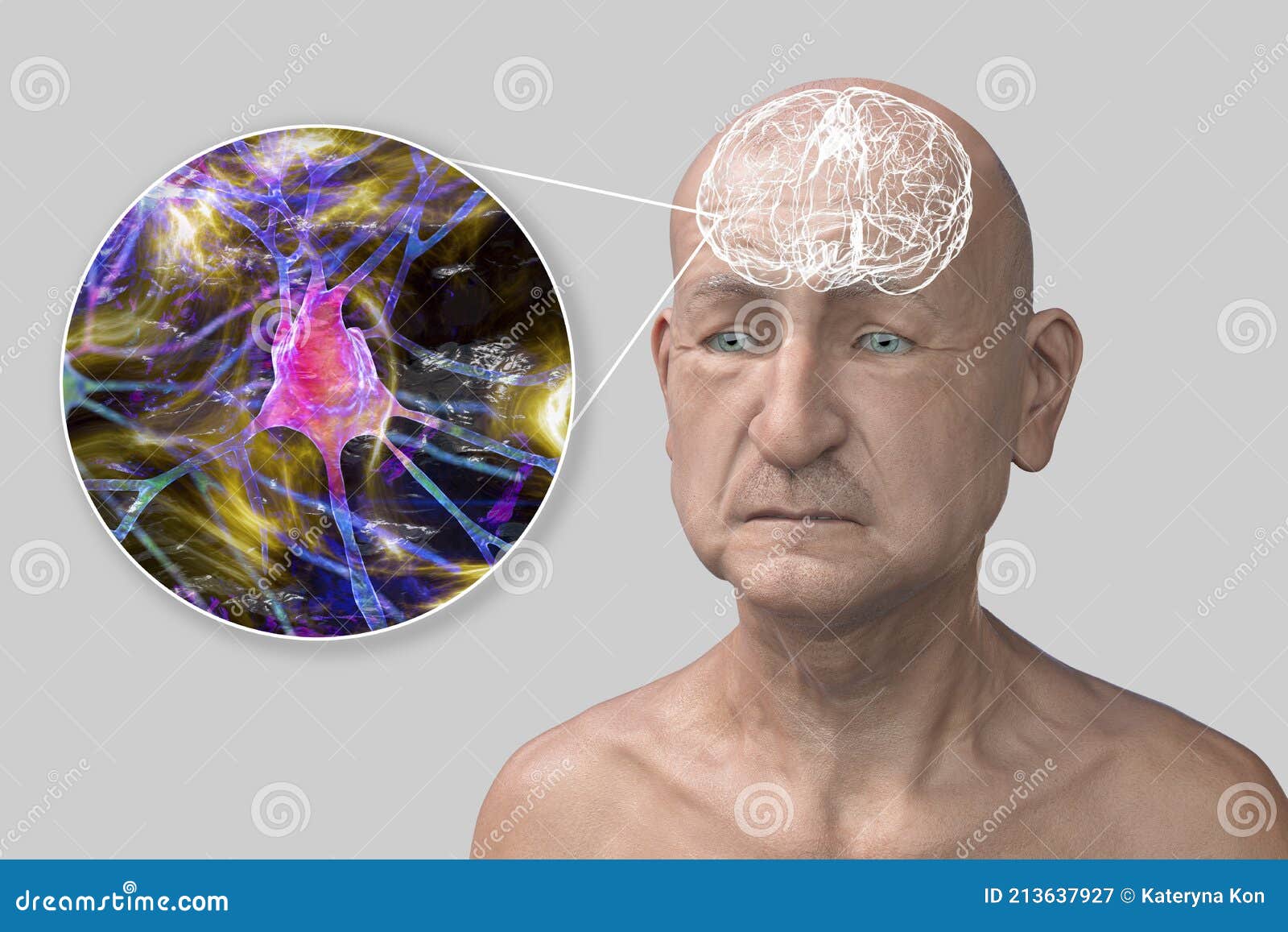 Dementia, Conceptual Illustration, Computer Illustration Stock ... Dementia, Conceptual Illustration, Computer Illustration Stock ...