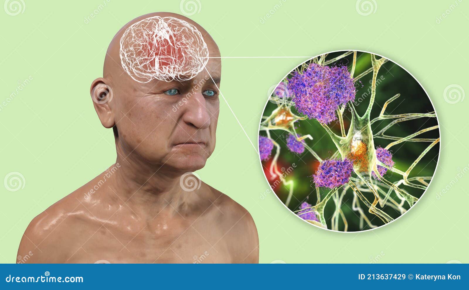 Dementia, Conceptual Illustration | CartoonDealer.com #213637699 Dementia, Conceptual Illustration | CartoonDealer.com #213637699
