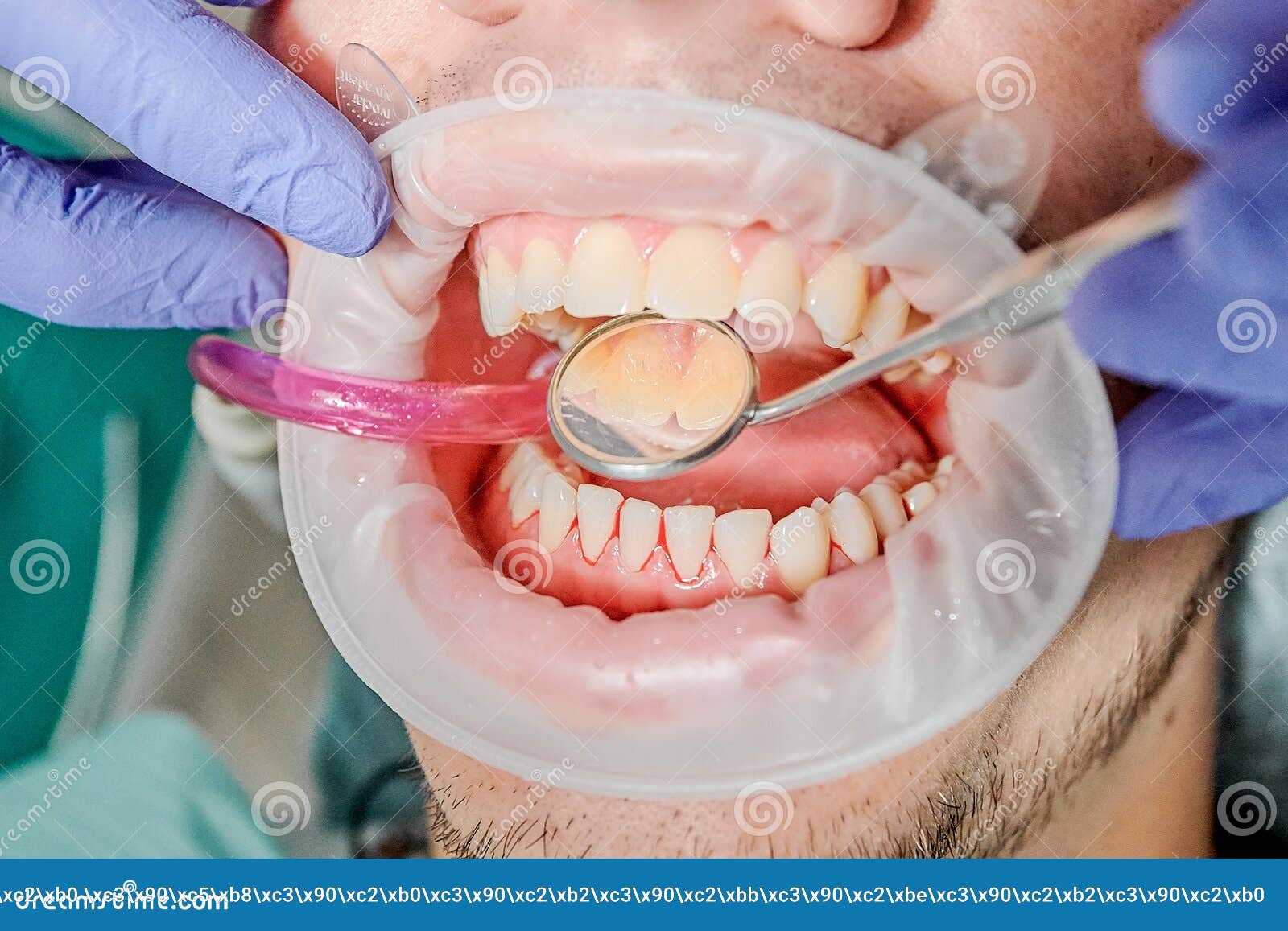 Demonstration of Teeth with a Saliva Pump at a Dentist`s Appointment ...