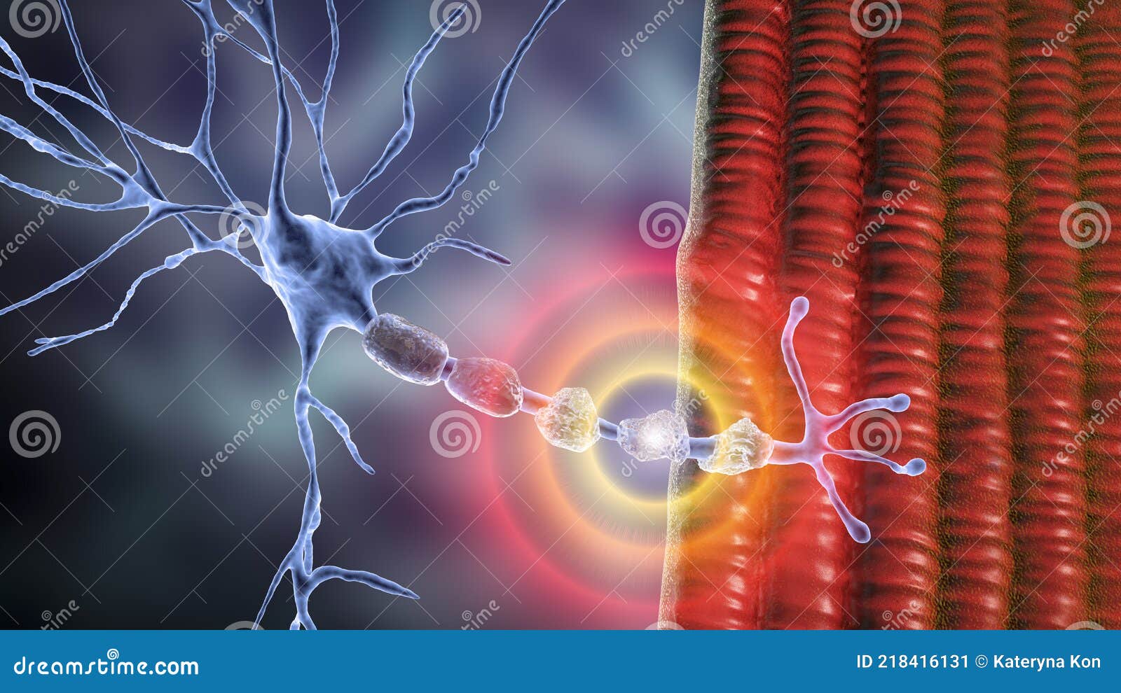 Demyelination Of A Neuron, The Damage Of The Neuron Myelin Sheath Seen ... Demyelination Of A Neuron, The Damage Of The Neuron Myelin Sheath Seen ...