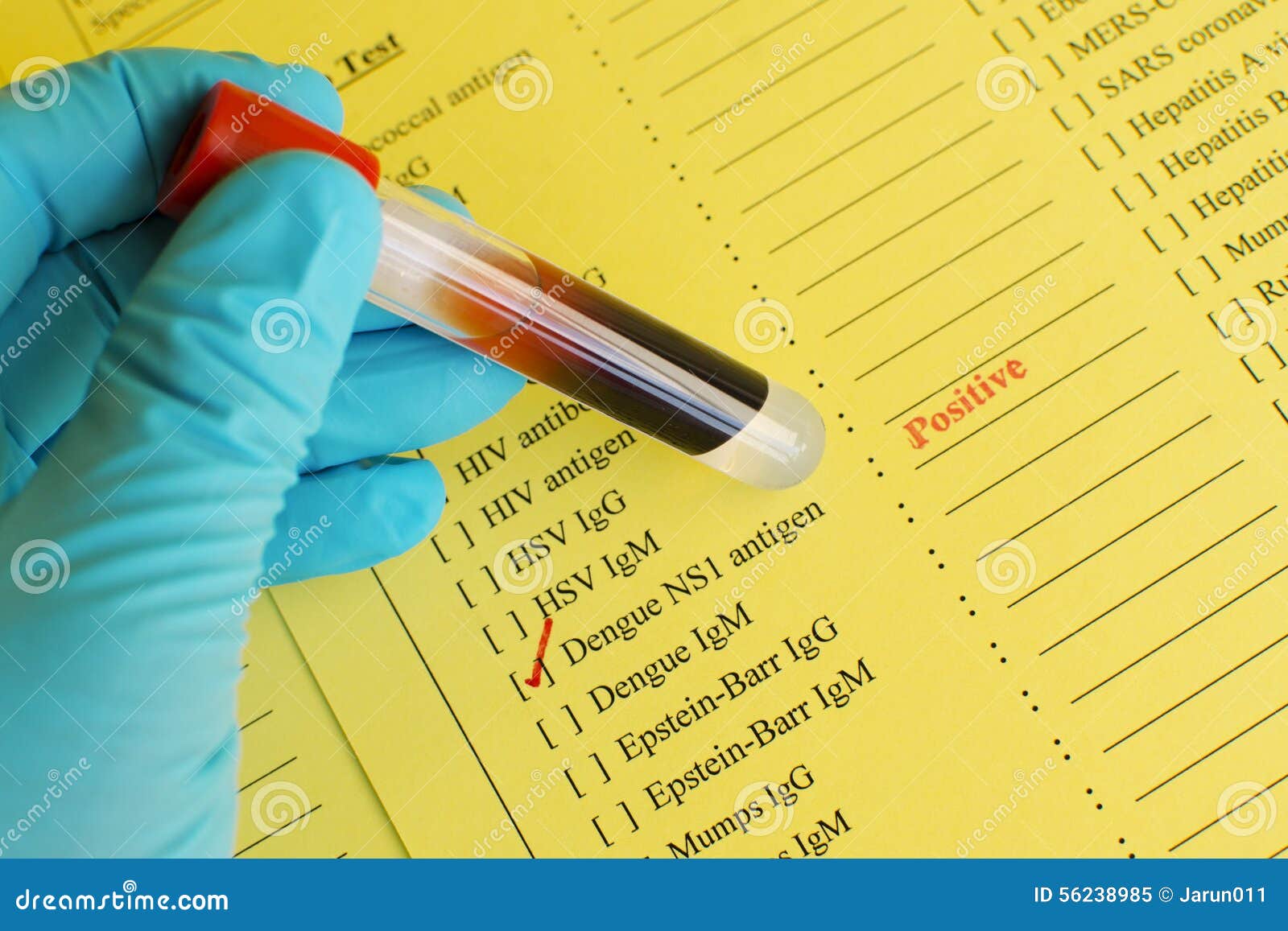 Dengue positive stock image. Image of test, research - 56238985