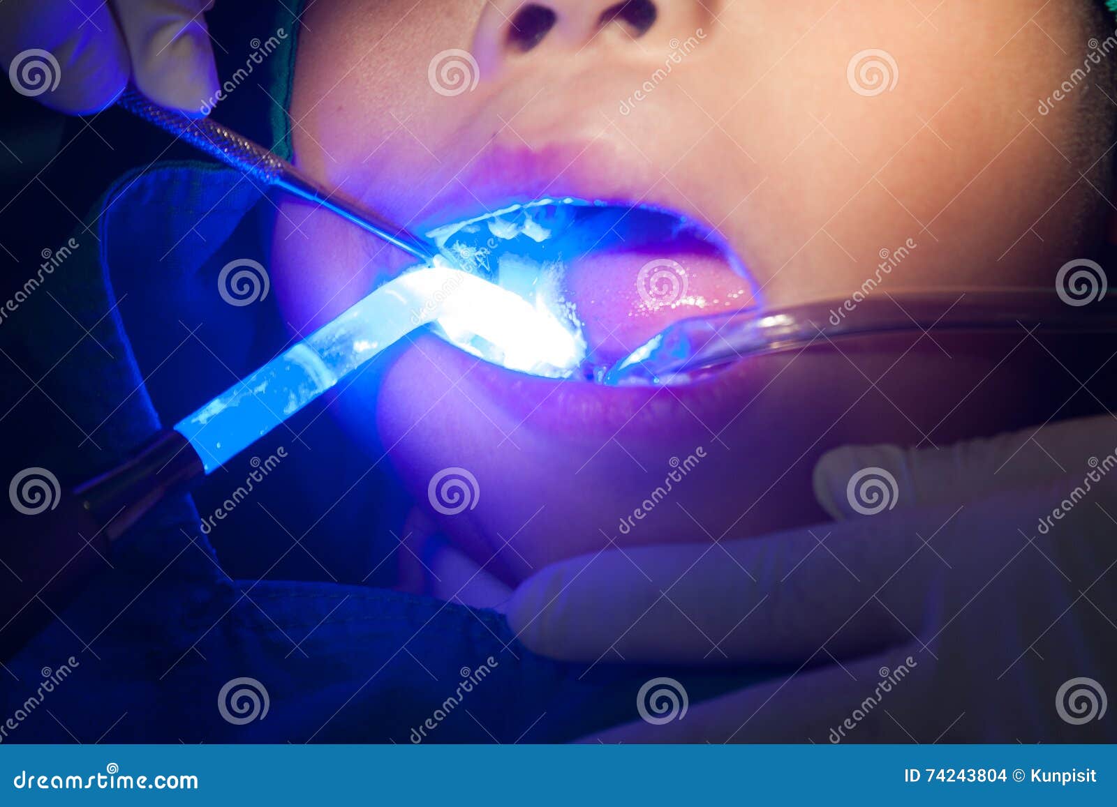 Dental stock photo. Image of device, light, dental, sealants - 74243804