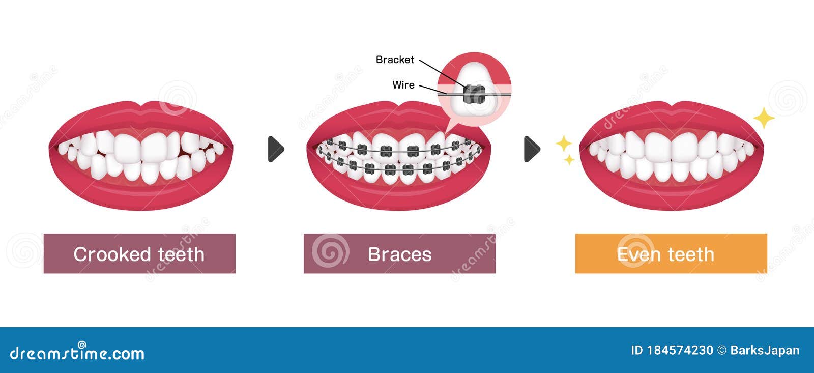 Dental Braces Process Vector Illustration Stock Vector - Illustration ...
