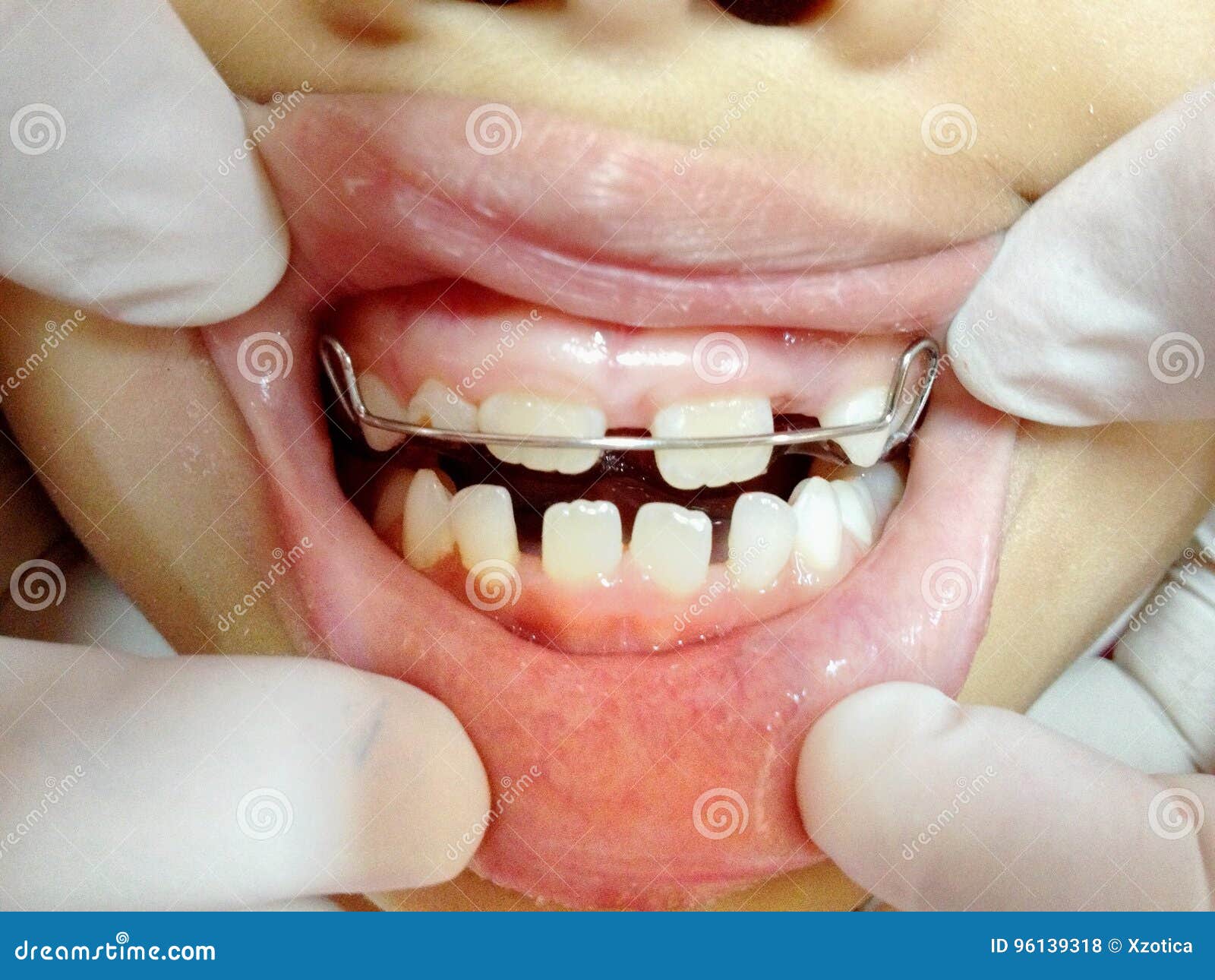 DEntal bracketing stock photo. Image of decay, gingivitis - 96139318