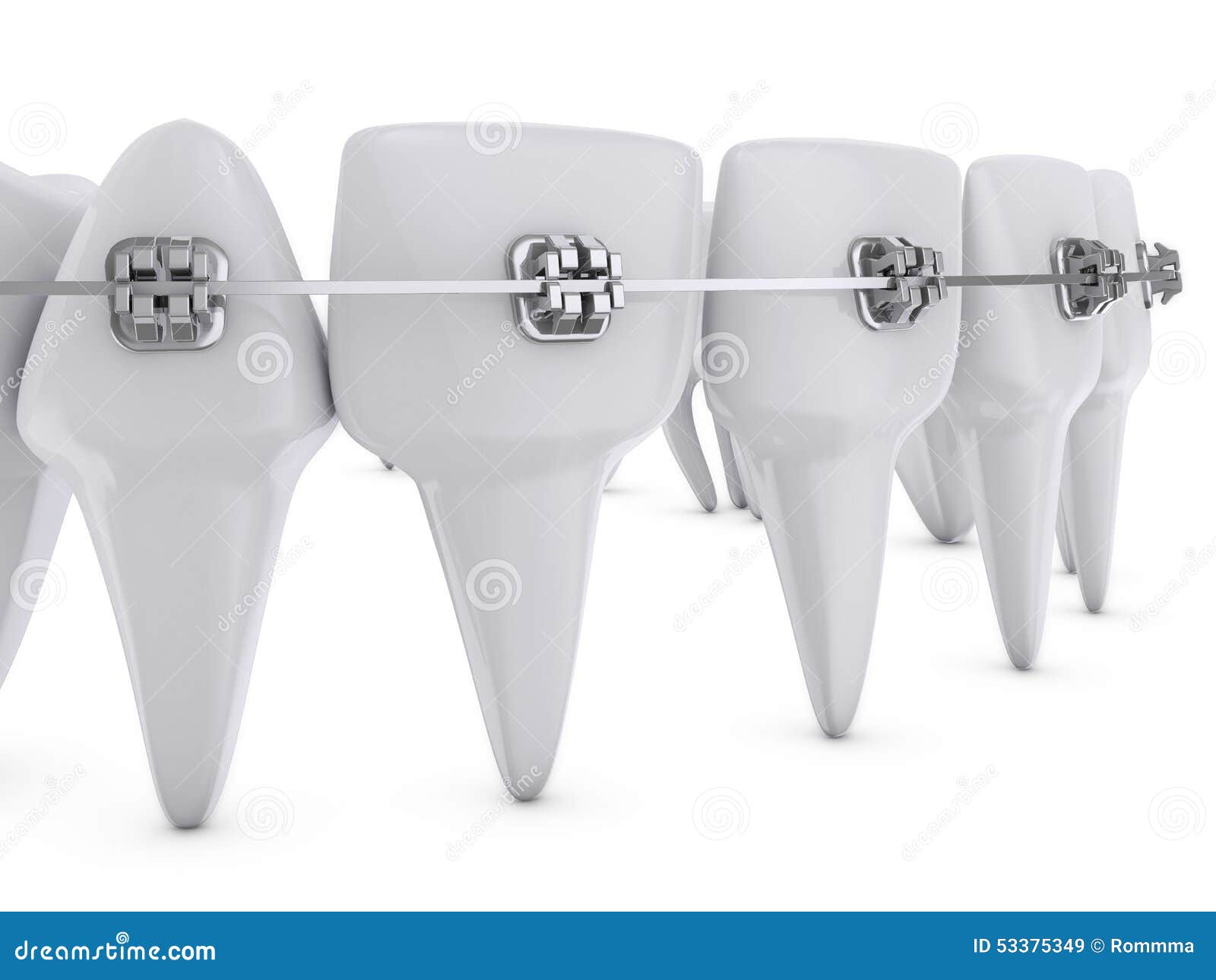 Dental brackets stock illustration. Illustration of teeth - 53375349