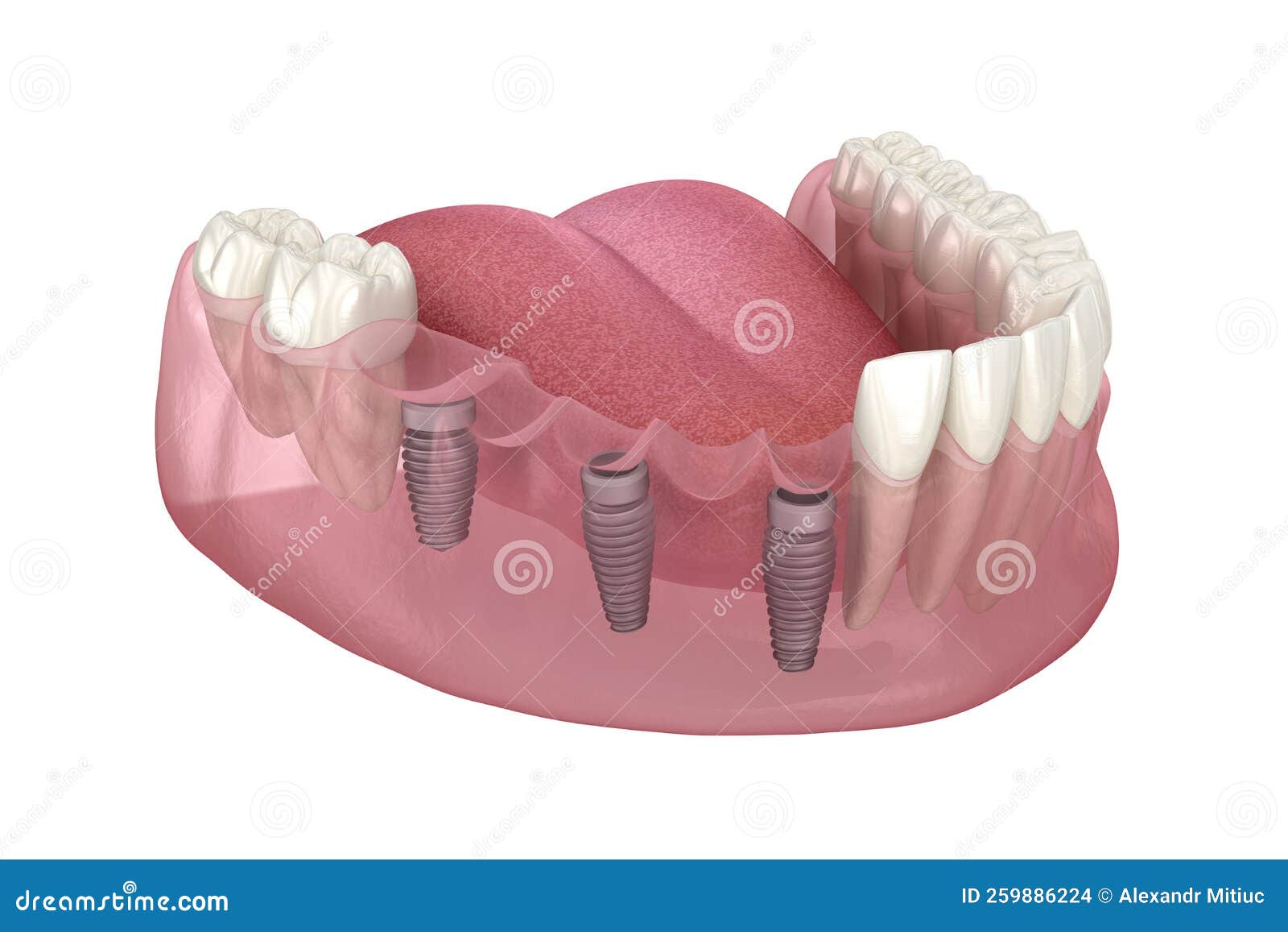 Dental Bridge Based on 3 Implants. Medically Accurate 3D Illustration ...