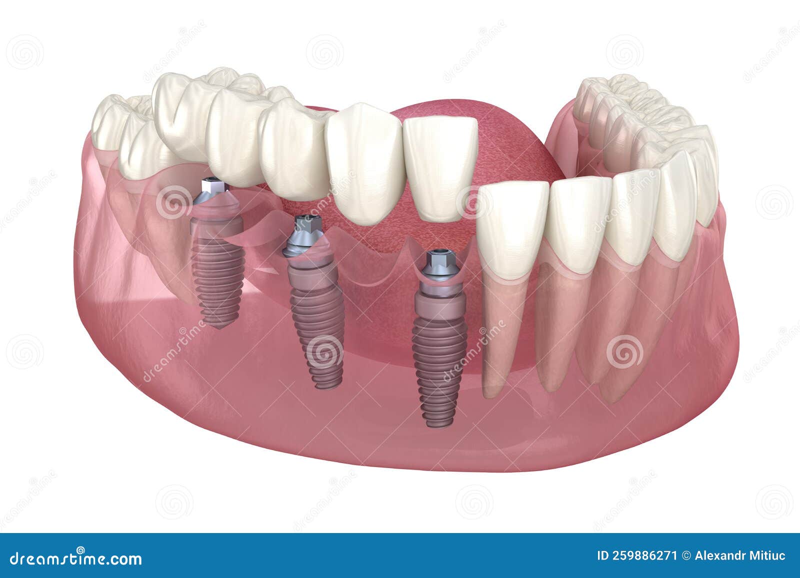 Dental Bridge Based on 3 Implants. Medically Accurate 3D Illustration ...