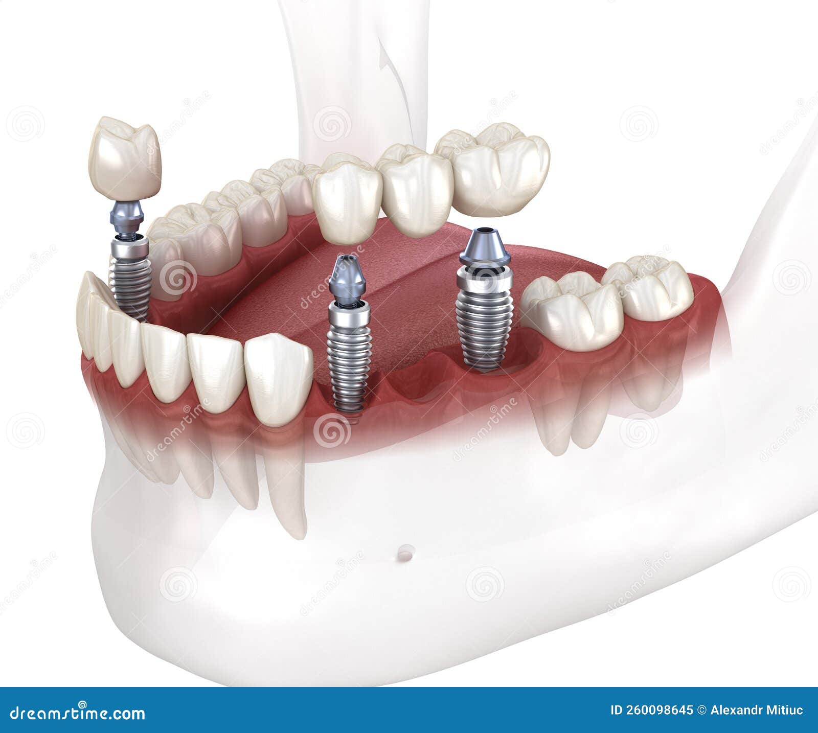 Dental Bridge and Crown Placement Over Implants. Dental 3D Animation ...