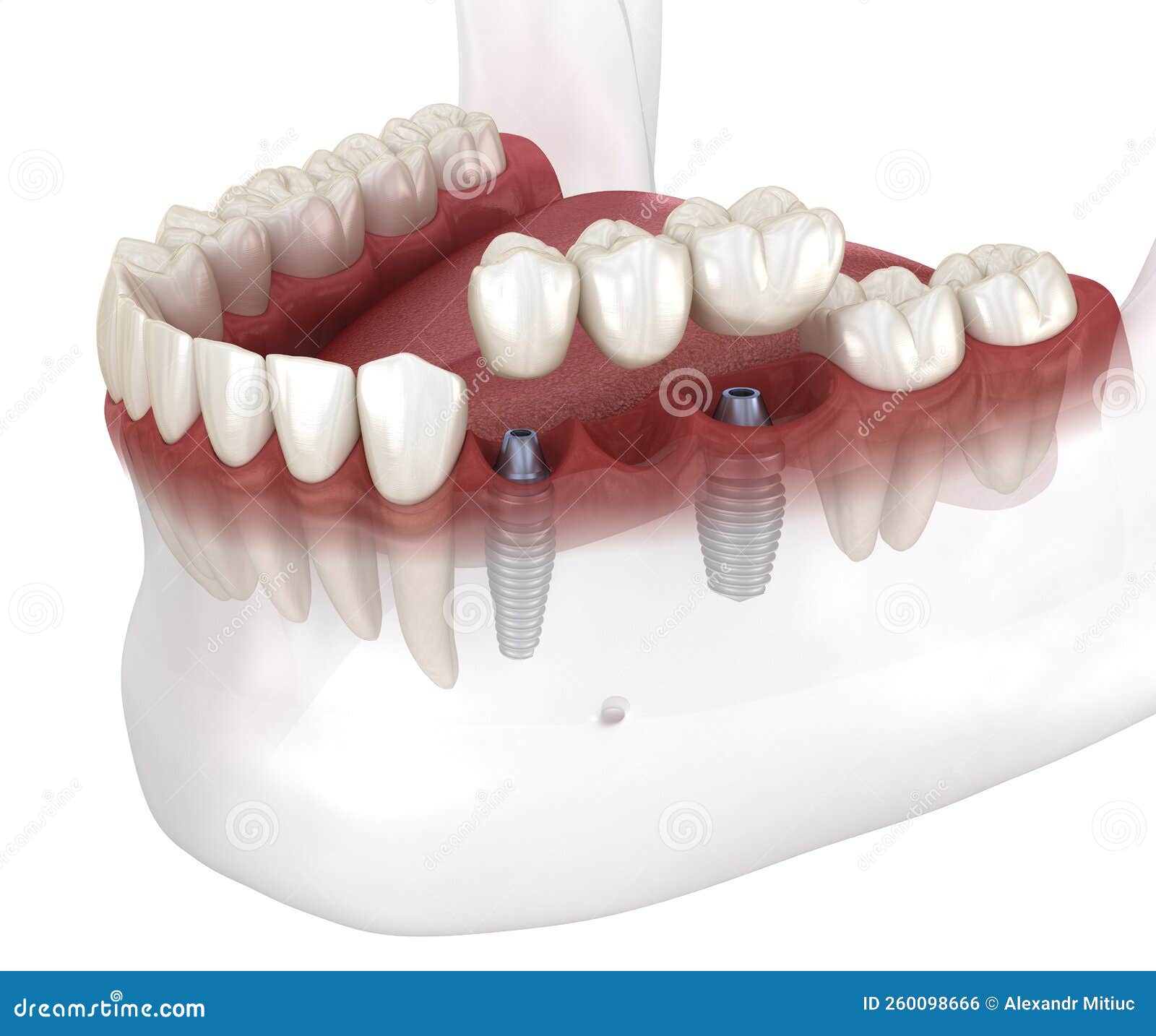 Dental Bridge and Crown Placement Over Implants. Dental 3D Animation ...