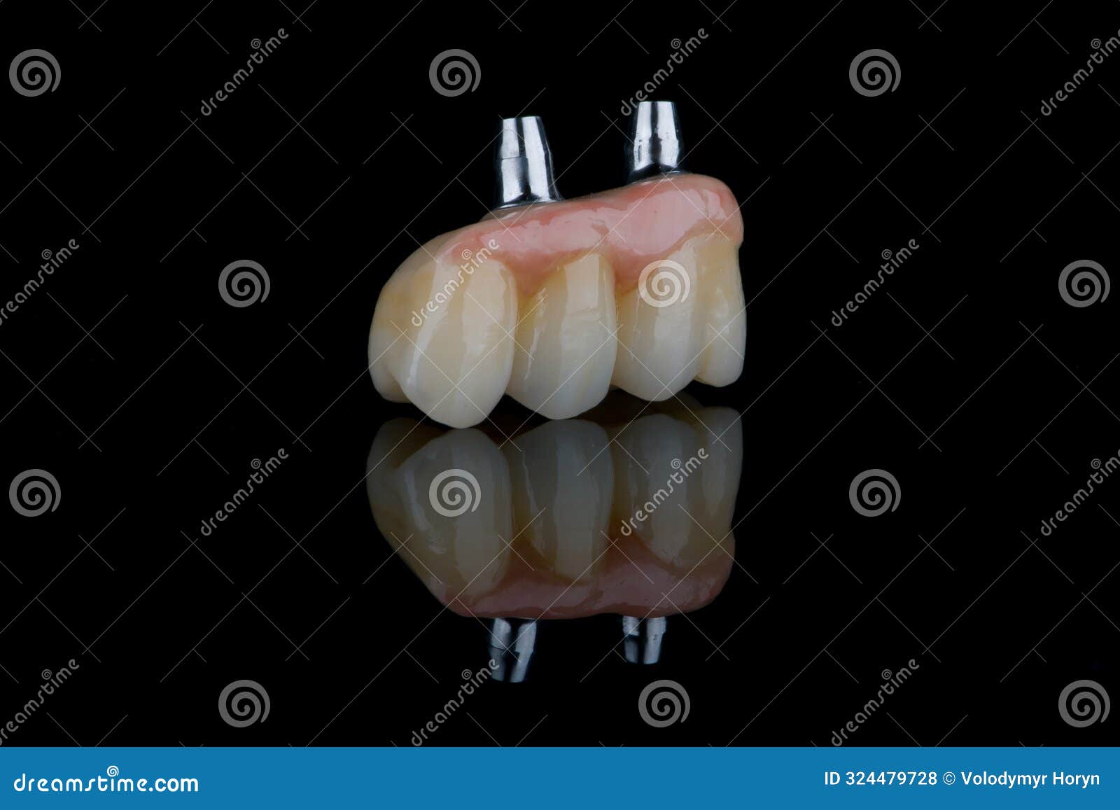 Dental Bridge Four Teeth and Artificial Gum Made of Monolithic ...