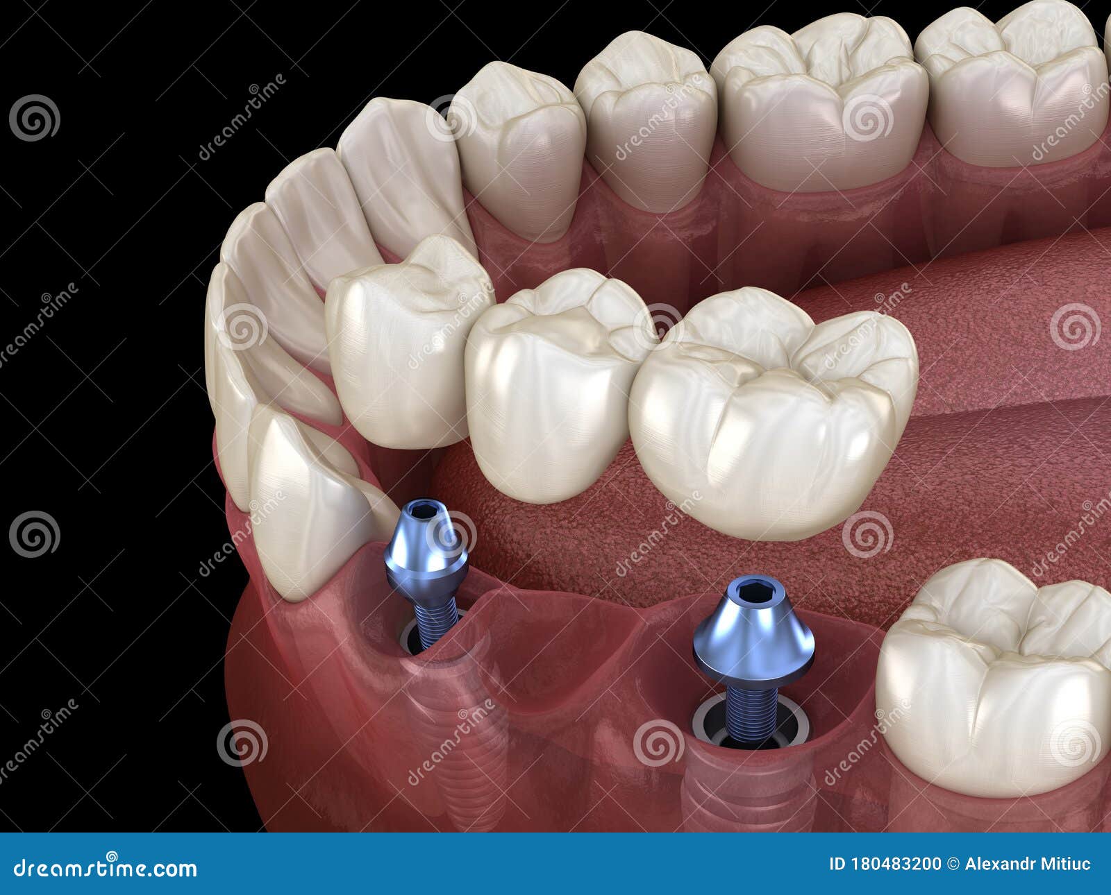 Dental Bridge Supported By Implants. Medically Accurate 3D Illustration ...