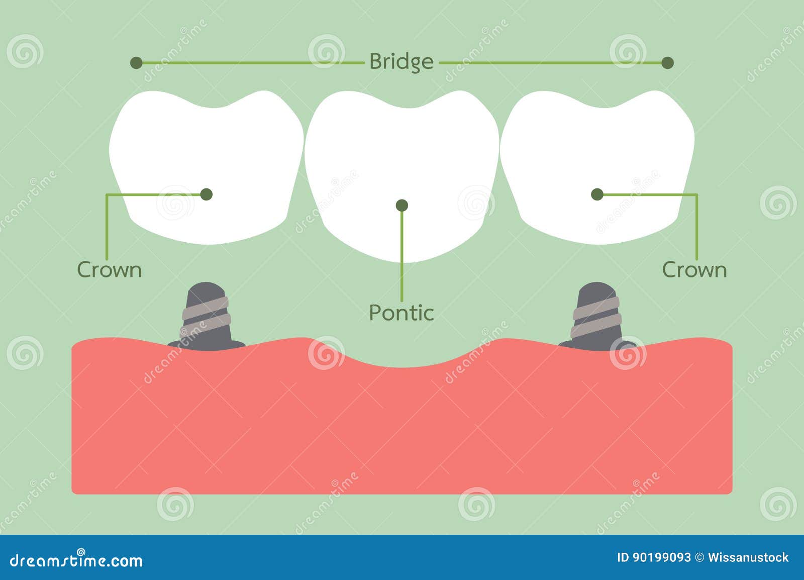Dental bridge stock vector. Illustration of cartoon, mouth - 90199093
